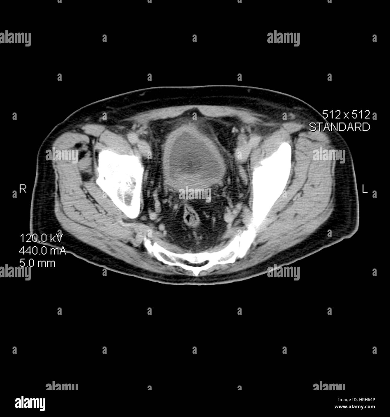 Abnormal ct of abdomen hi-res stock photography and images - Alamy