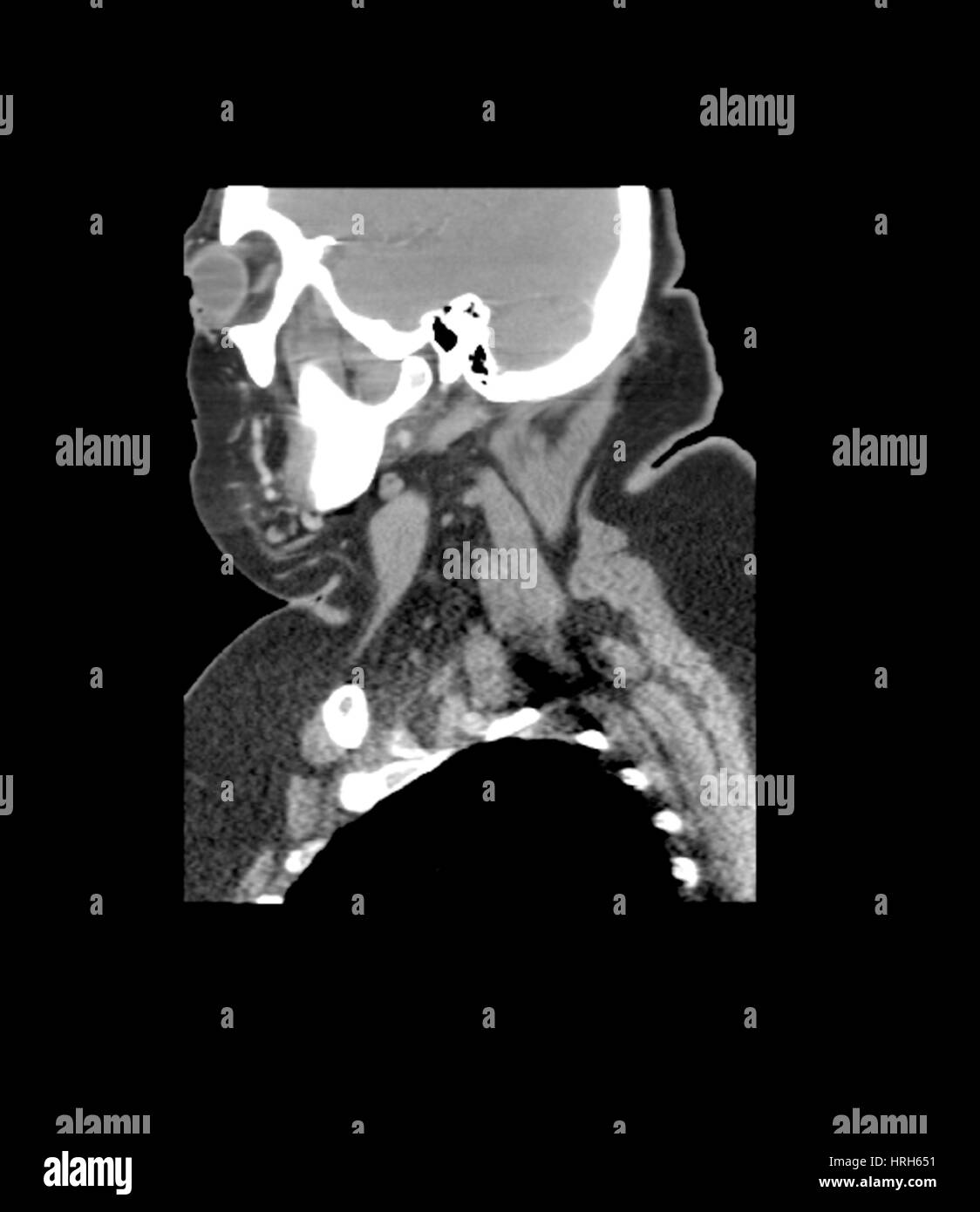 Ct scan abdomen Black and White Stock Photos & Images - Alamy