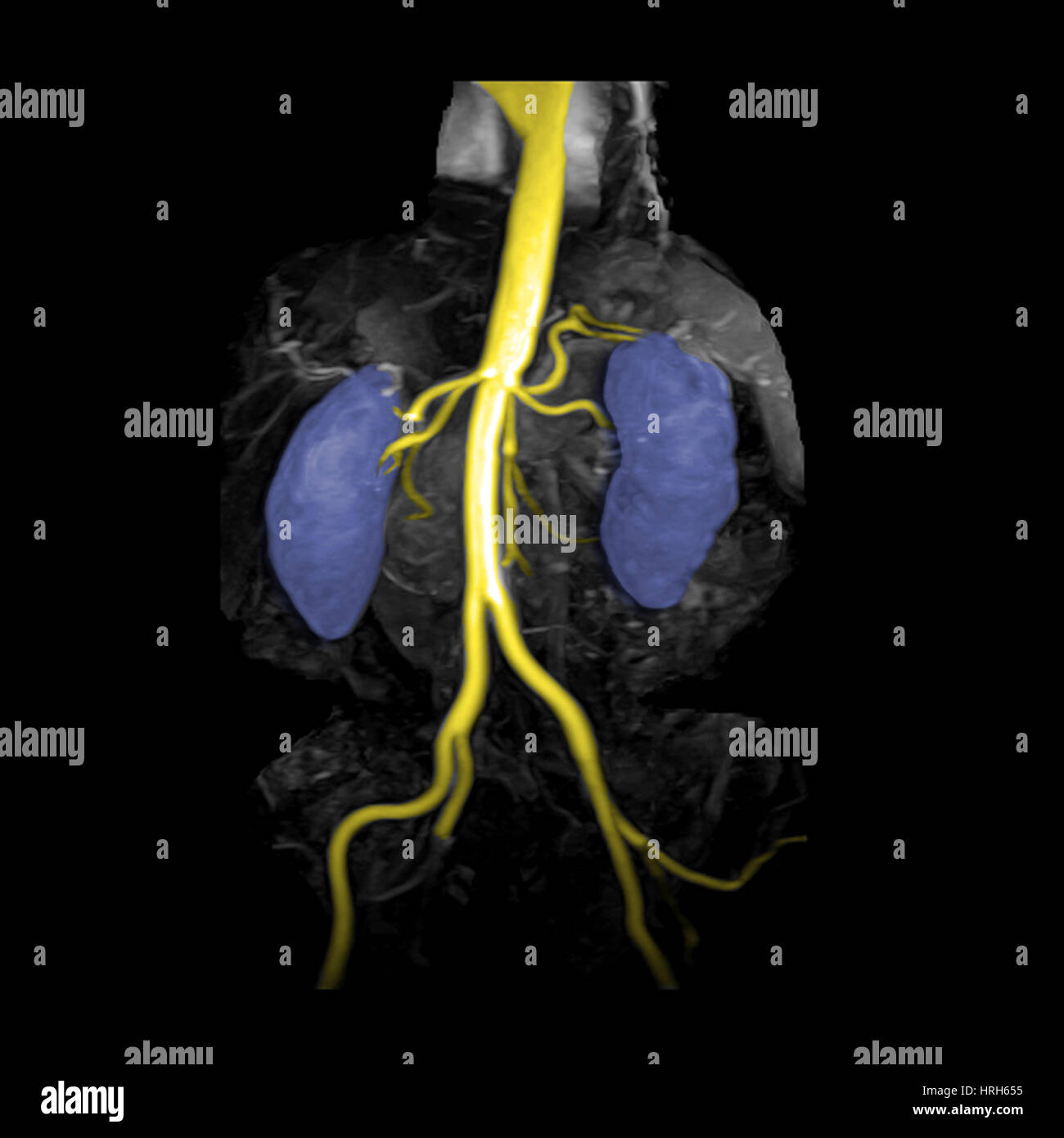 Aorta abdominal normal hi-res stock photography and images - Alamy