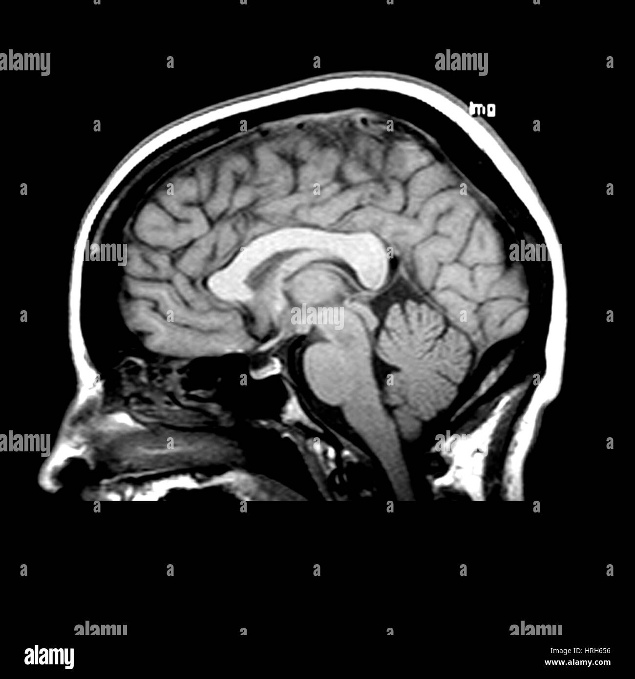 Normal Brain Mri Black and White Stock Photos & Images - Alamy