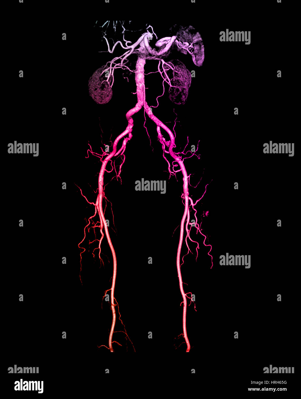 Abdominal ct scan abdomen hi-res stock photography and images - Alamy Abdominal ct scan abdomen hi-res stock photography and images - Alamy
