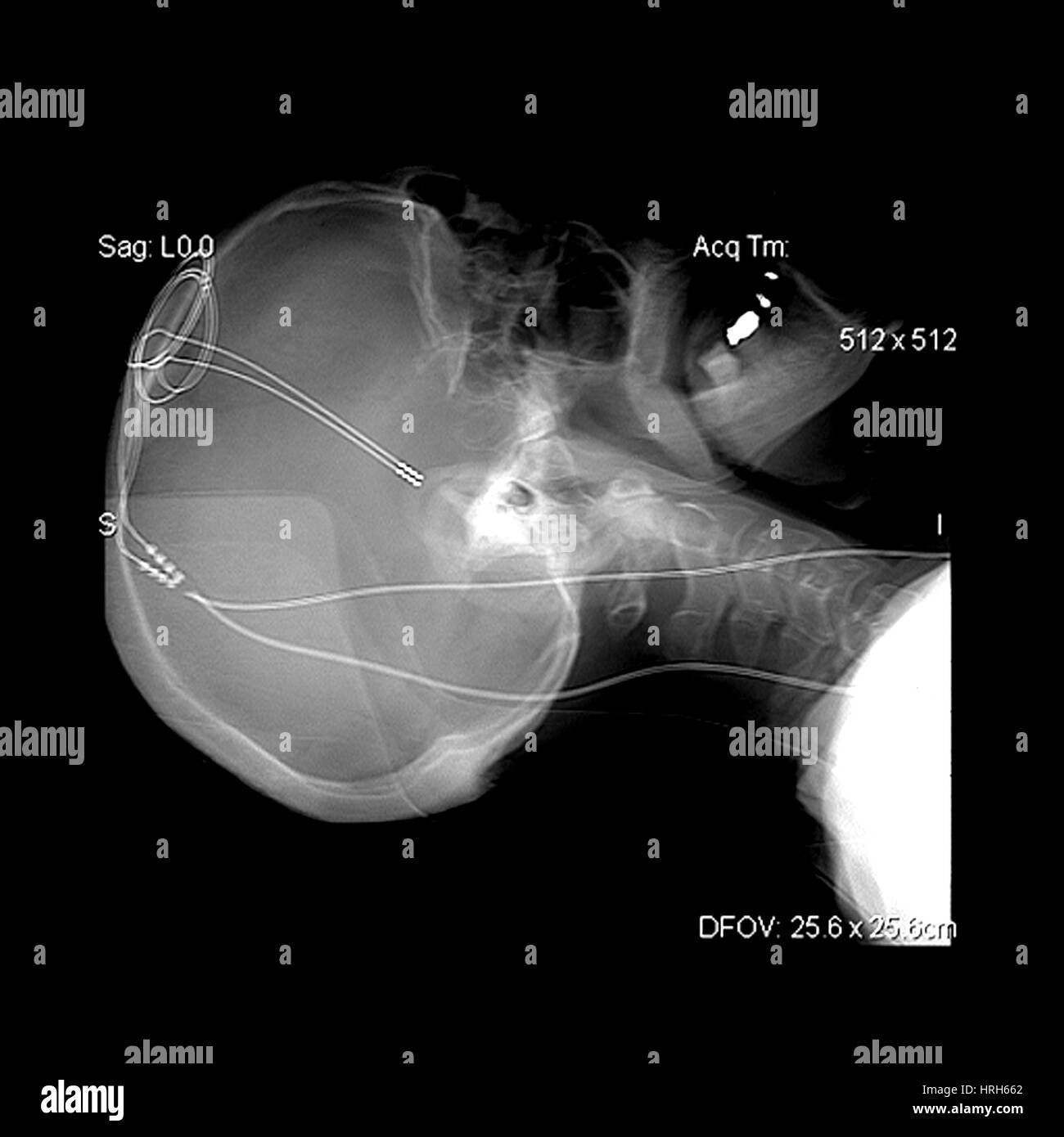 Lateral x ray of deep electrodes hi-res stock photography and images ...