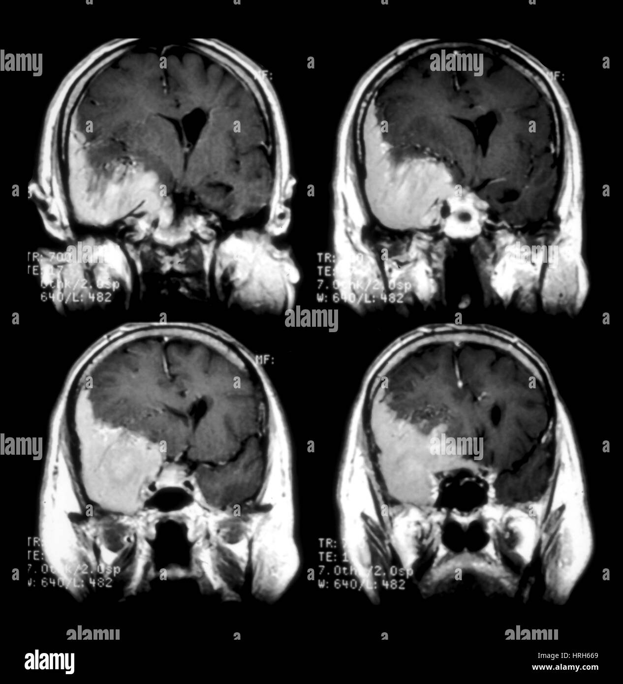 Mri of extra axial brain tumor Black and White Stock Photos & Images ...