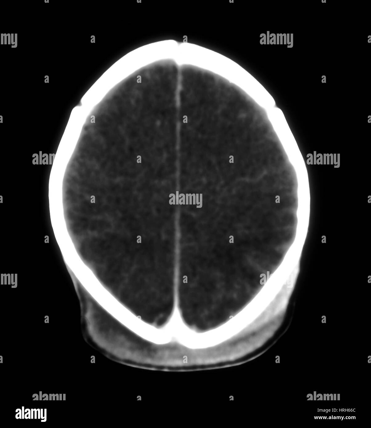 Brain Damage from Lack of Oxygen Stock Photo - Alamy