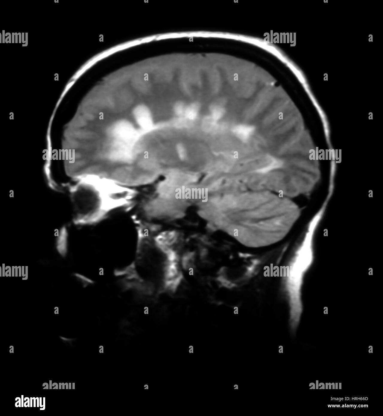 Multiple sclerosis Black and White Stock Photos & Images - Alamy