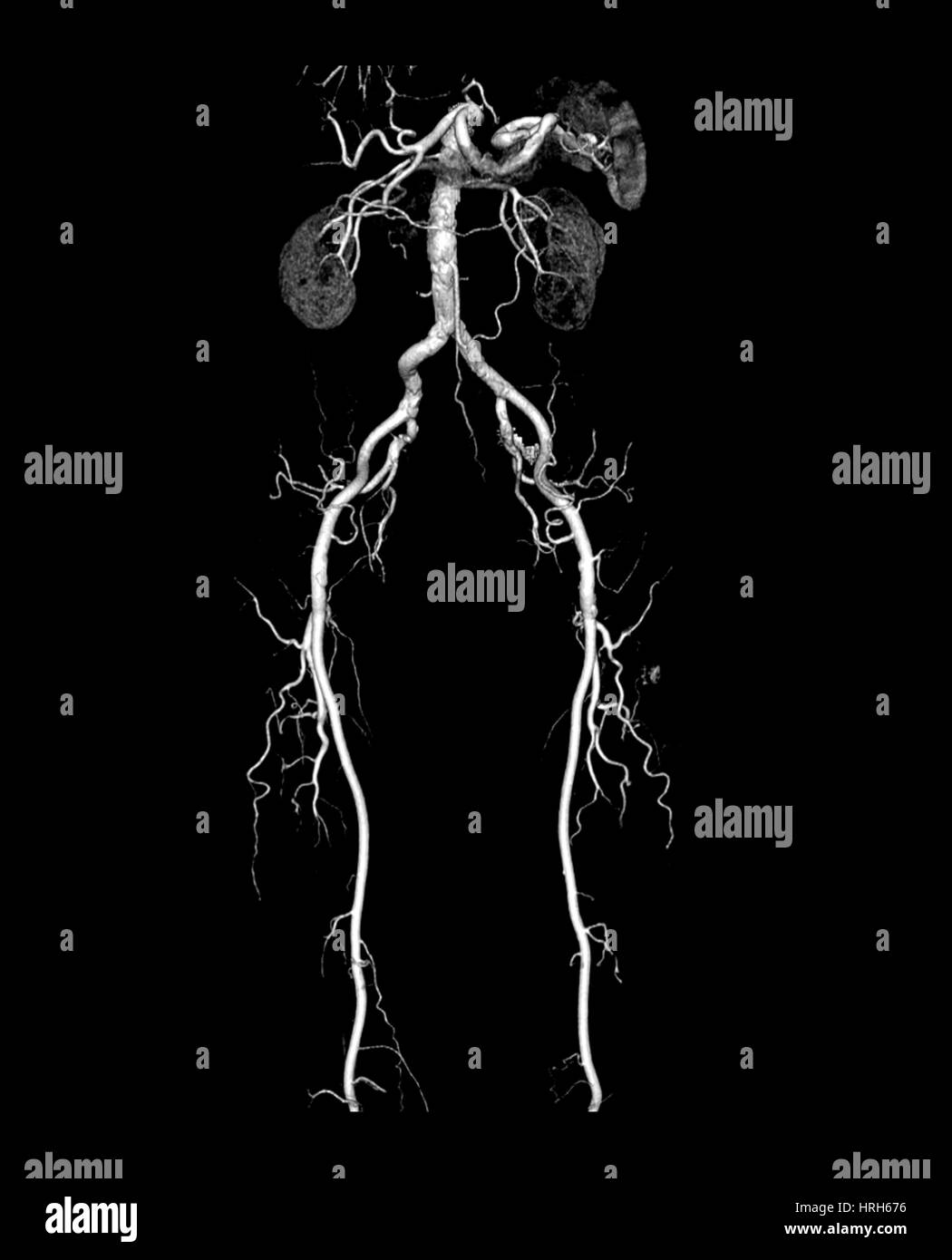 Iliac blood vessels Black and White Stock Photos & Images - Alamy