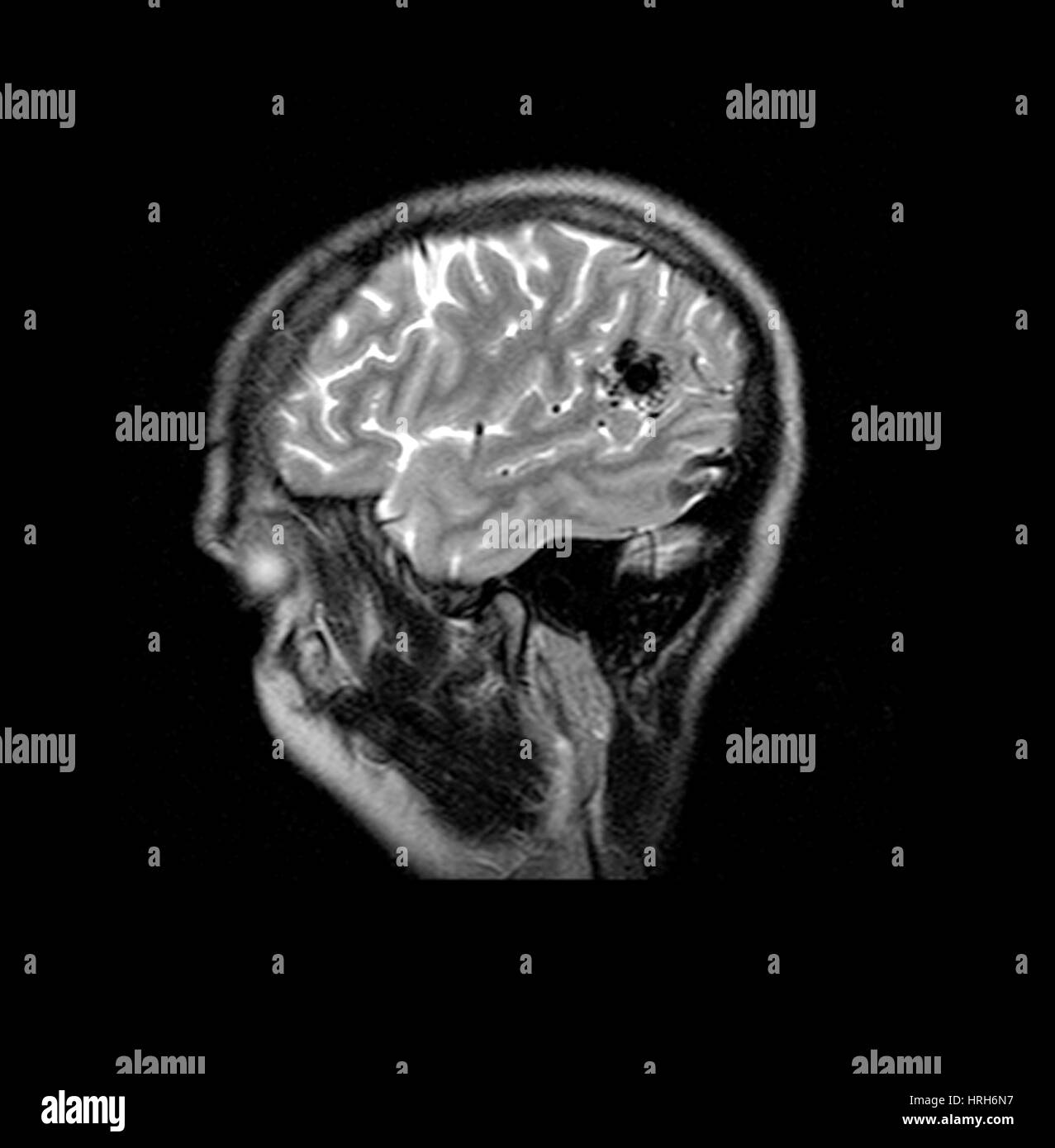 MRI of Brain AVM Stock Photo - Alamy
