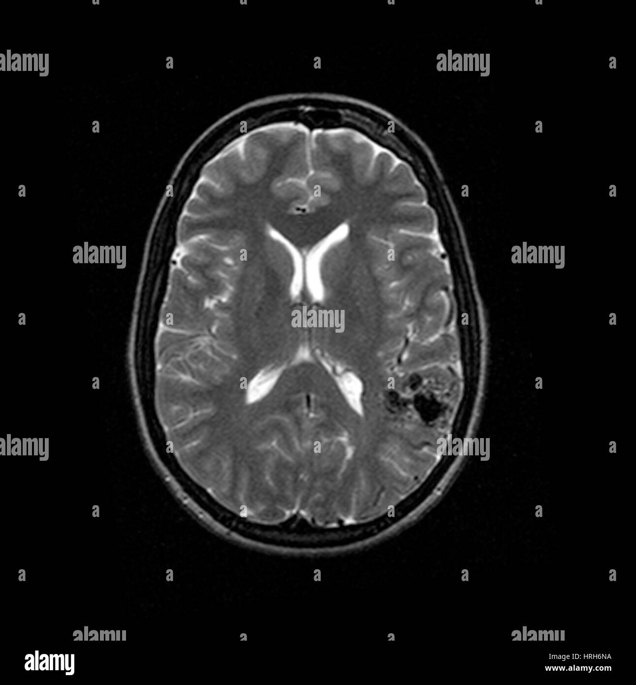Mri cerebral arterial venous malformation Black and White Stock Photos ...