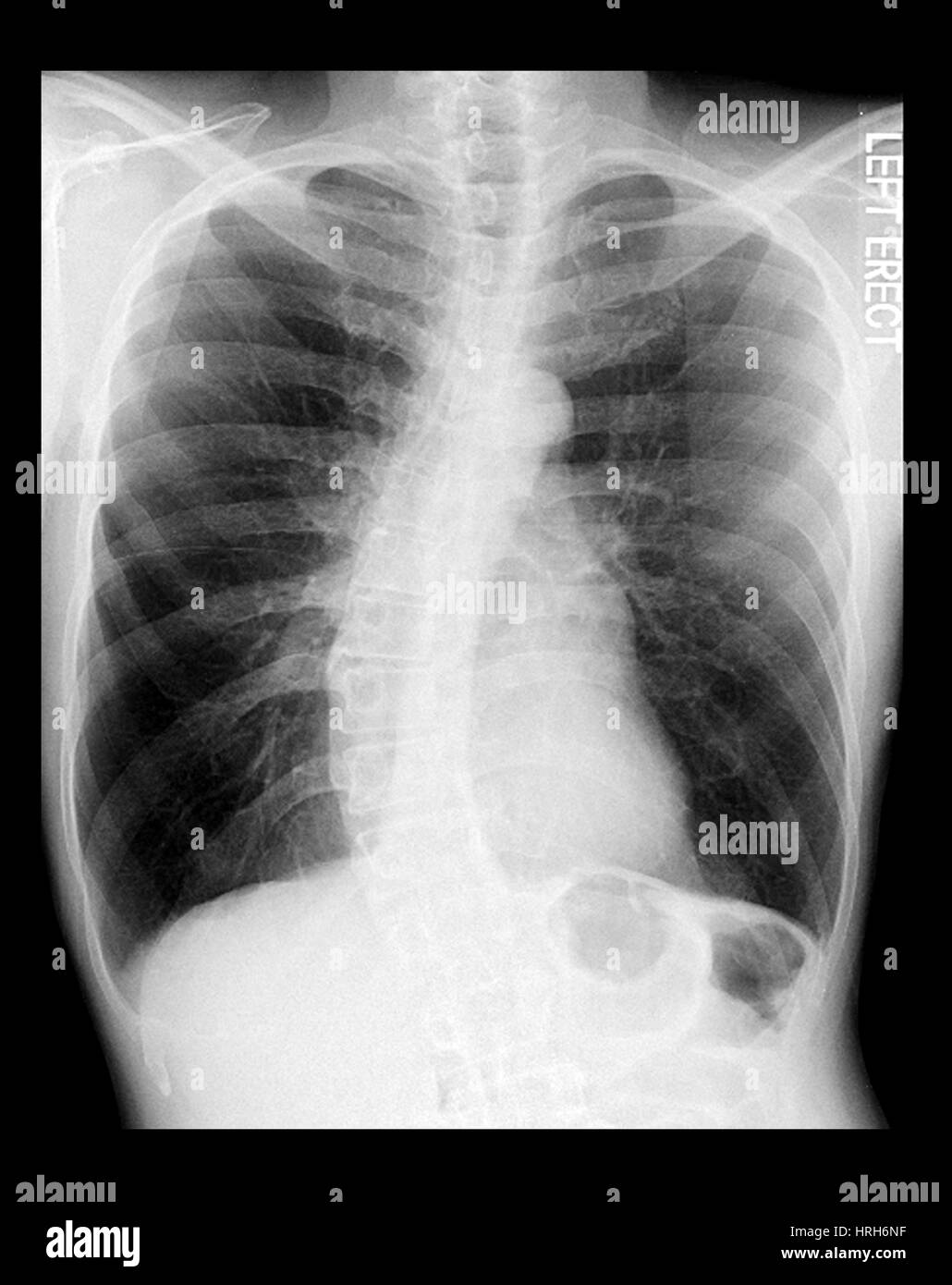 Chest X Ray For Copd Patient At Adeline Moore Blog