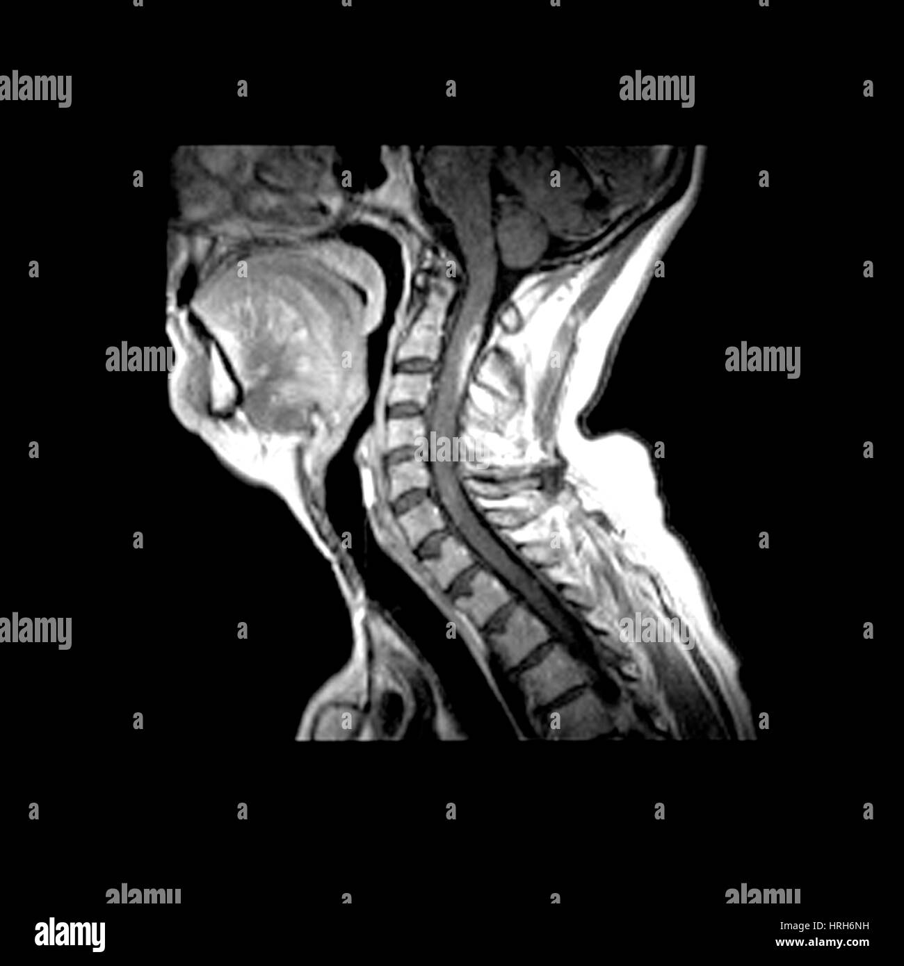 Mri of spinal cord abnormality hi-res stock photography and images - Alamy