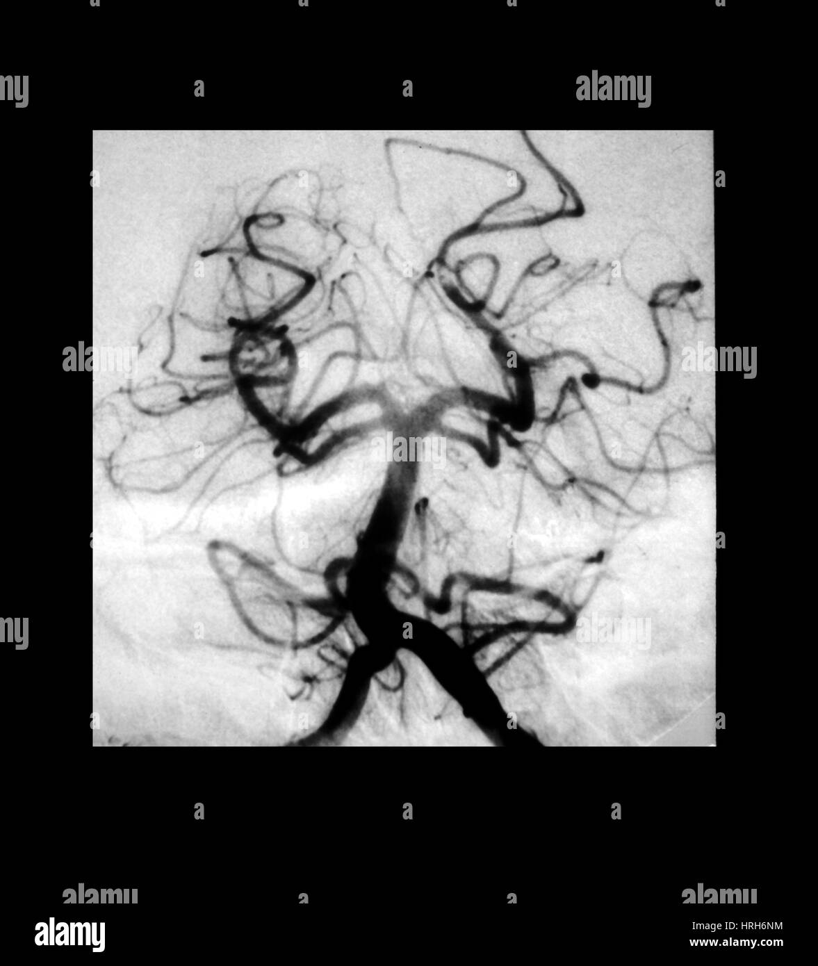 Angiogram of abnormal posterior cerebral artery Black and White Stock ...