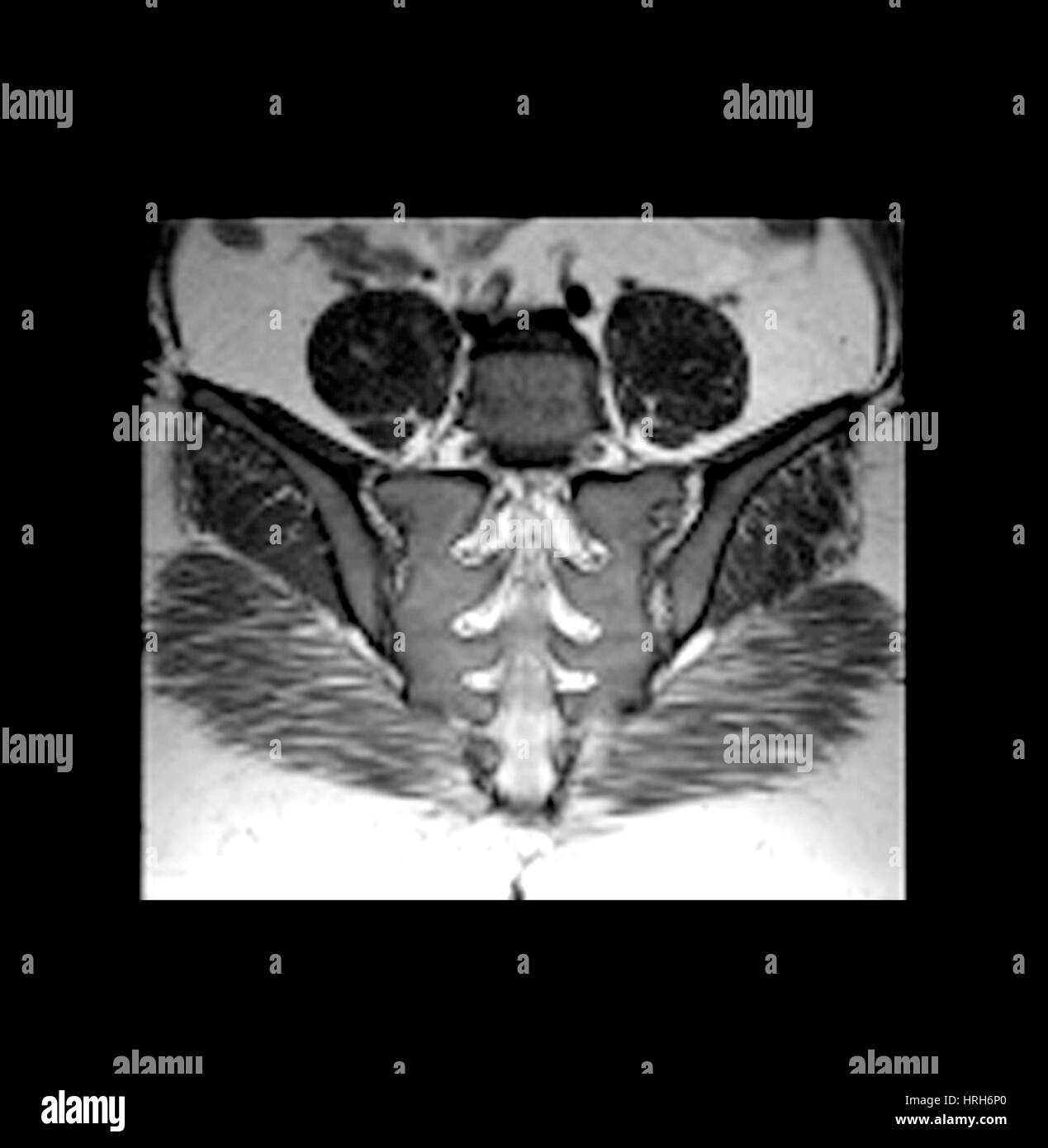 MRI Of Normal Sacrum Stock Photo Alamy mri-of-normal-sacrum-stock-photo-alamy