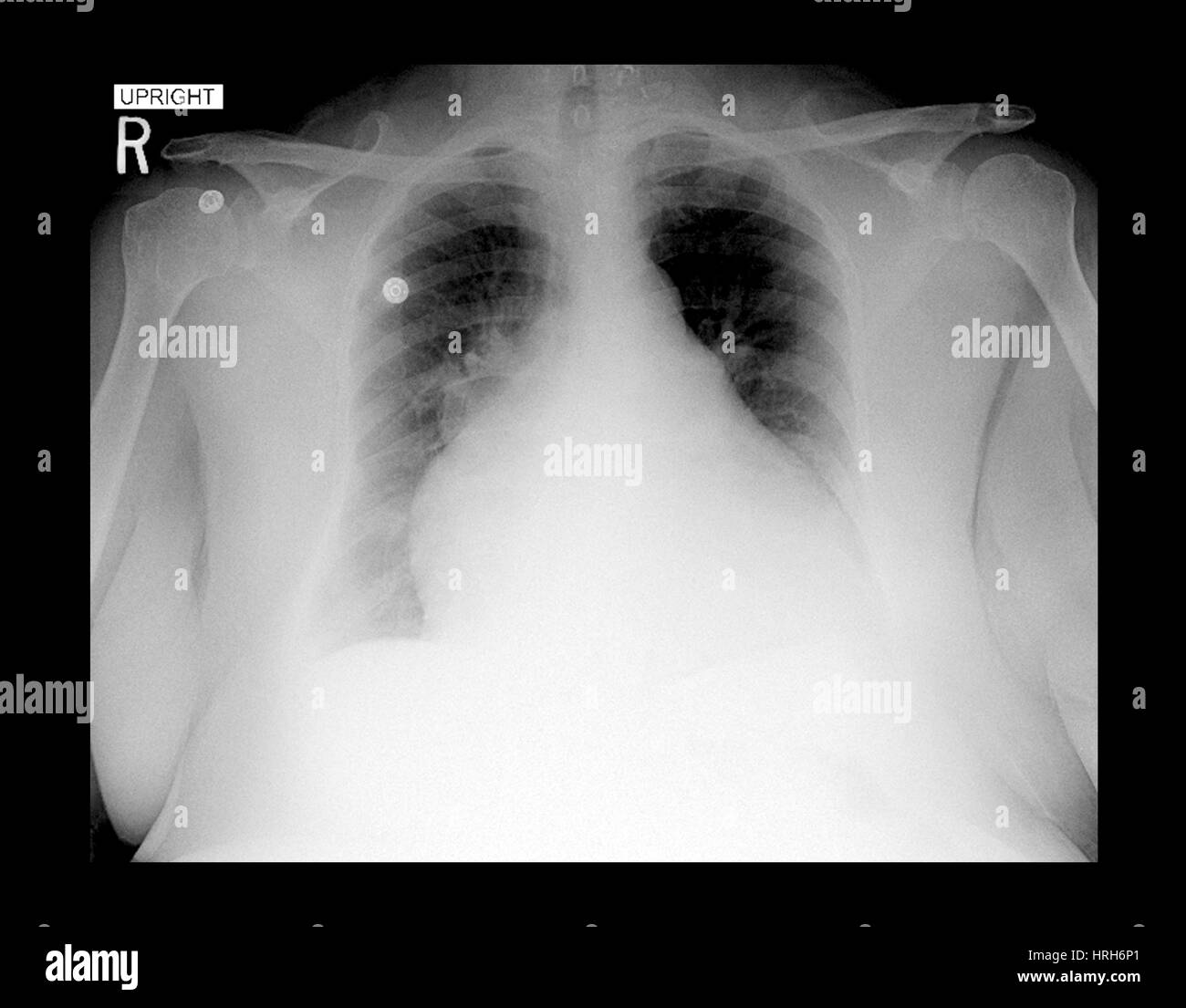 Cephalization Definition Chest X Ray at Frank Jobe blog