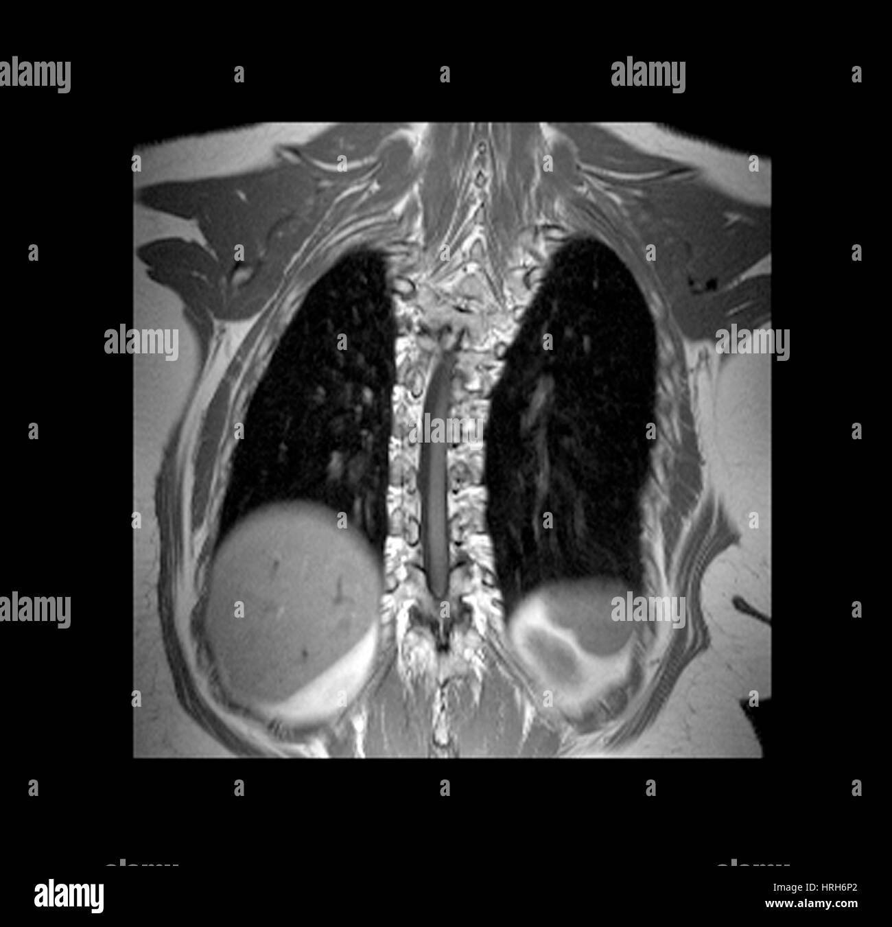 MRI of Thoracic Scoliosis Stock Photo - Alamy