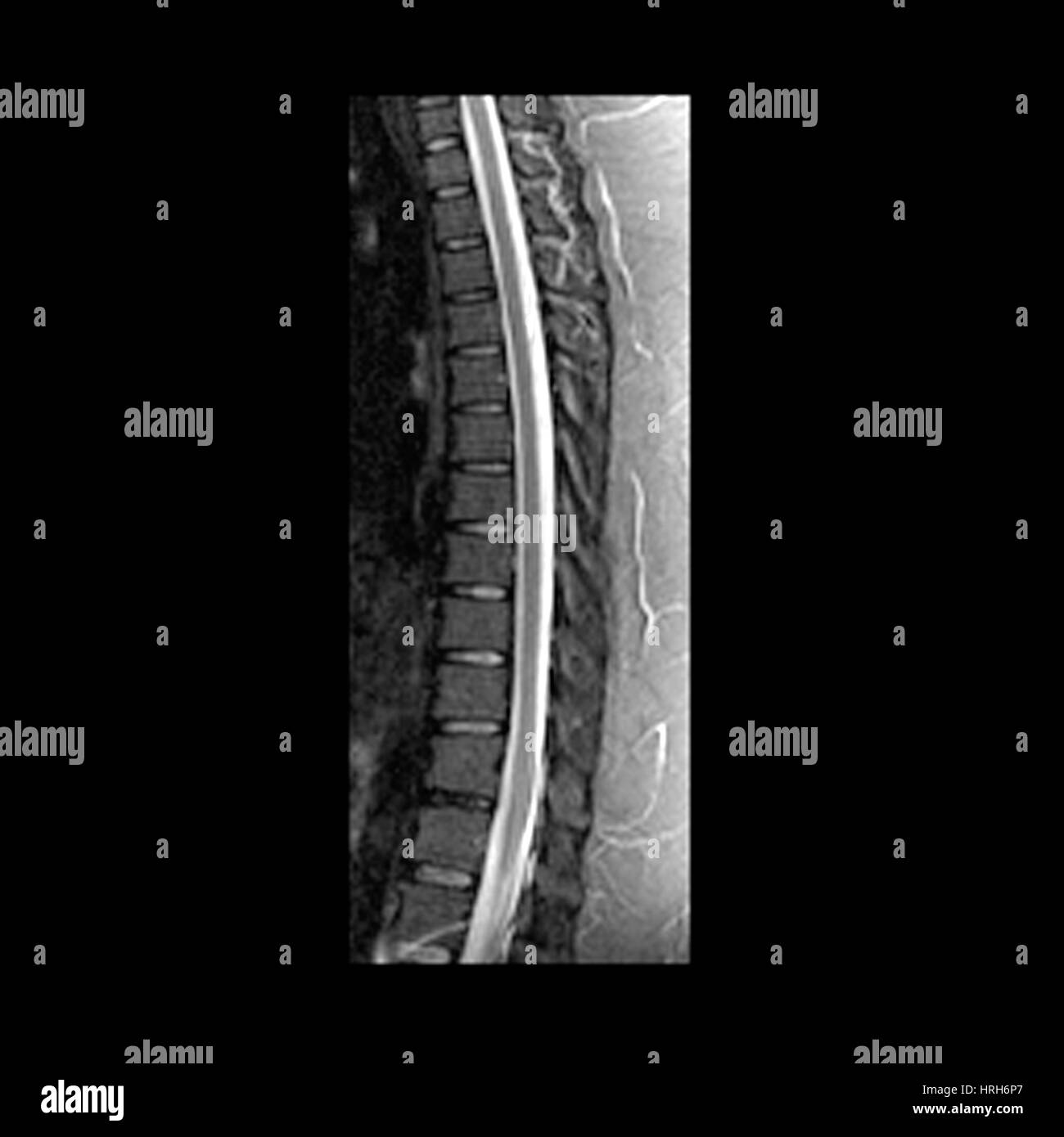 Normal Thoracic Spine Mri