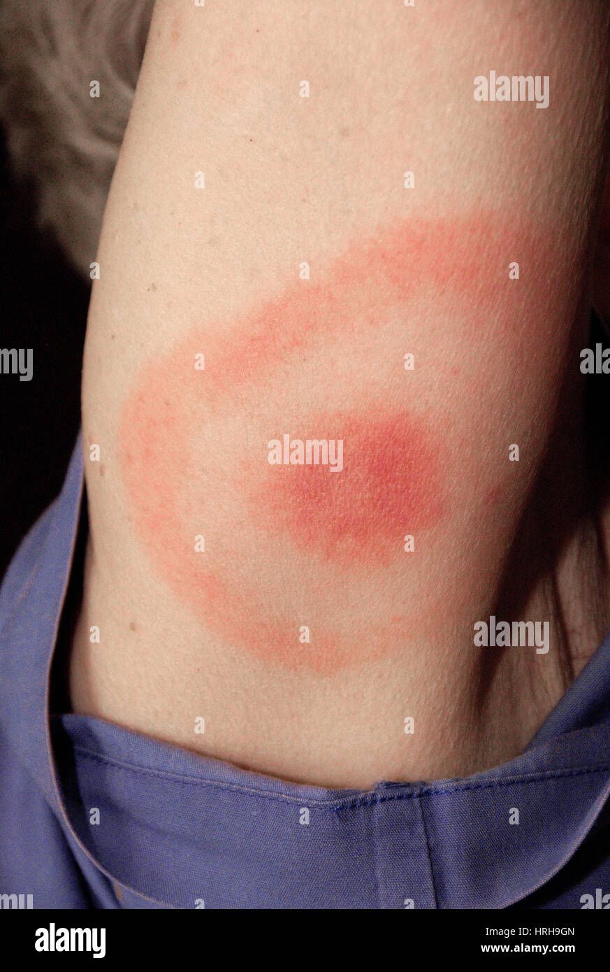 Lyme disease rash hi-res stock photography and images - Alamy