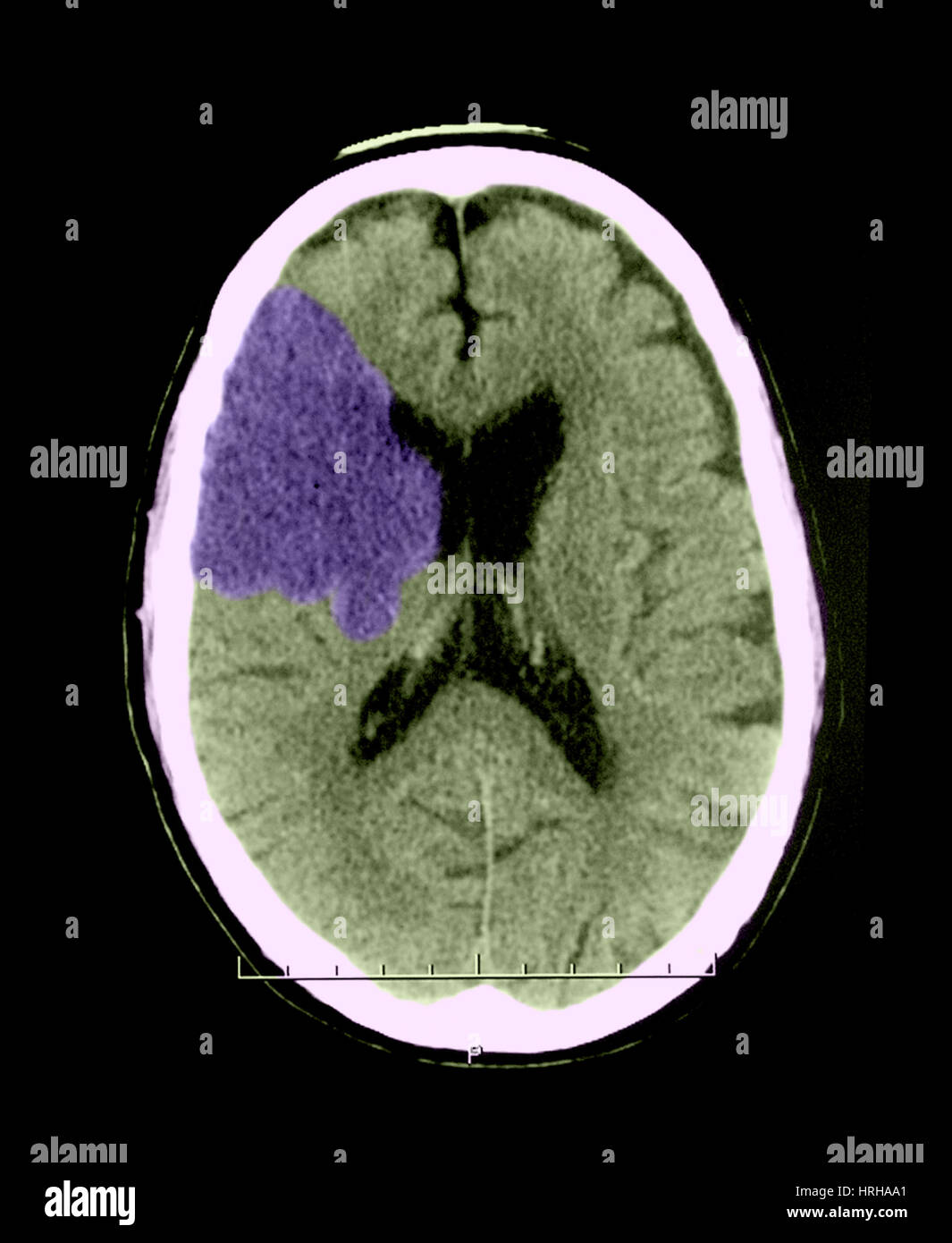 Abnormal ct of brain hi-res stock photography and images - Alamy