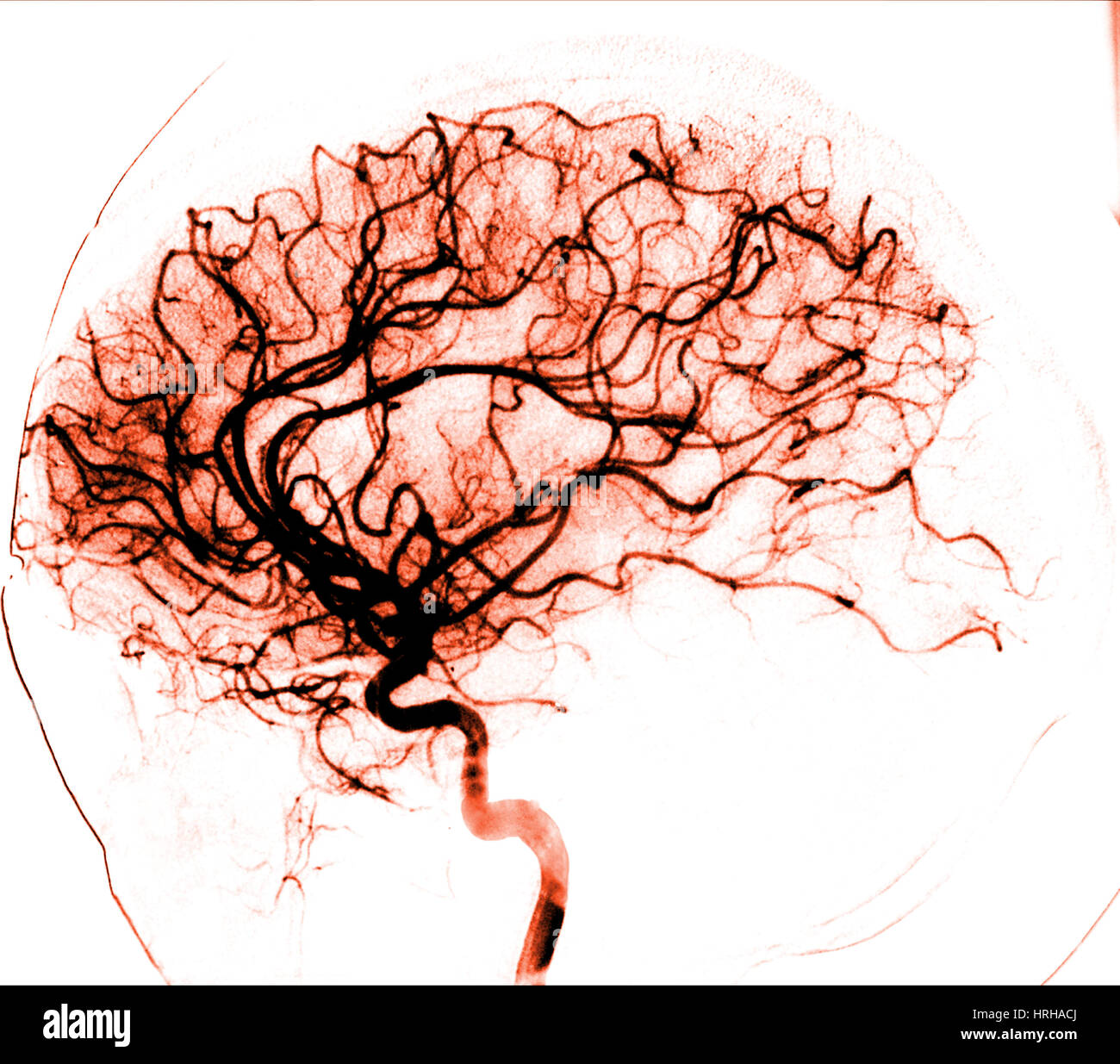 Cerebral angiography hi-res stock photography and images - Alamy