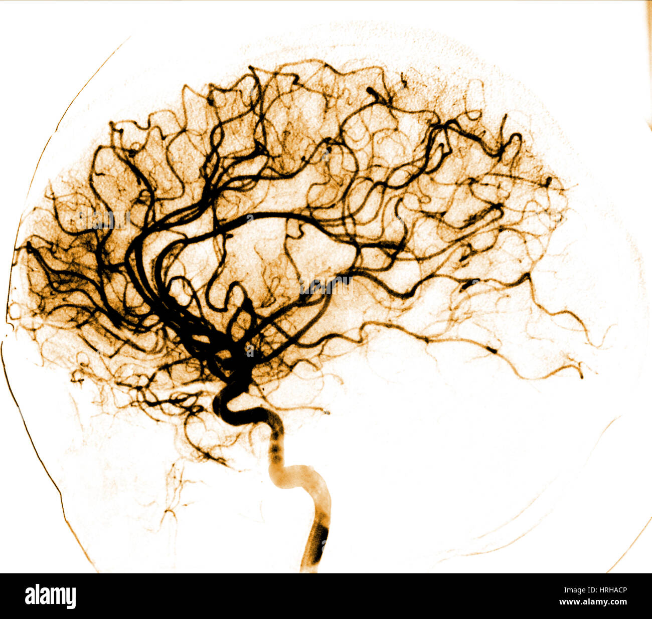 Anterior cerebral artery hi-res stock photography and images - Alamy