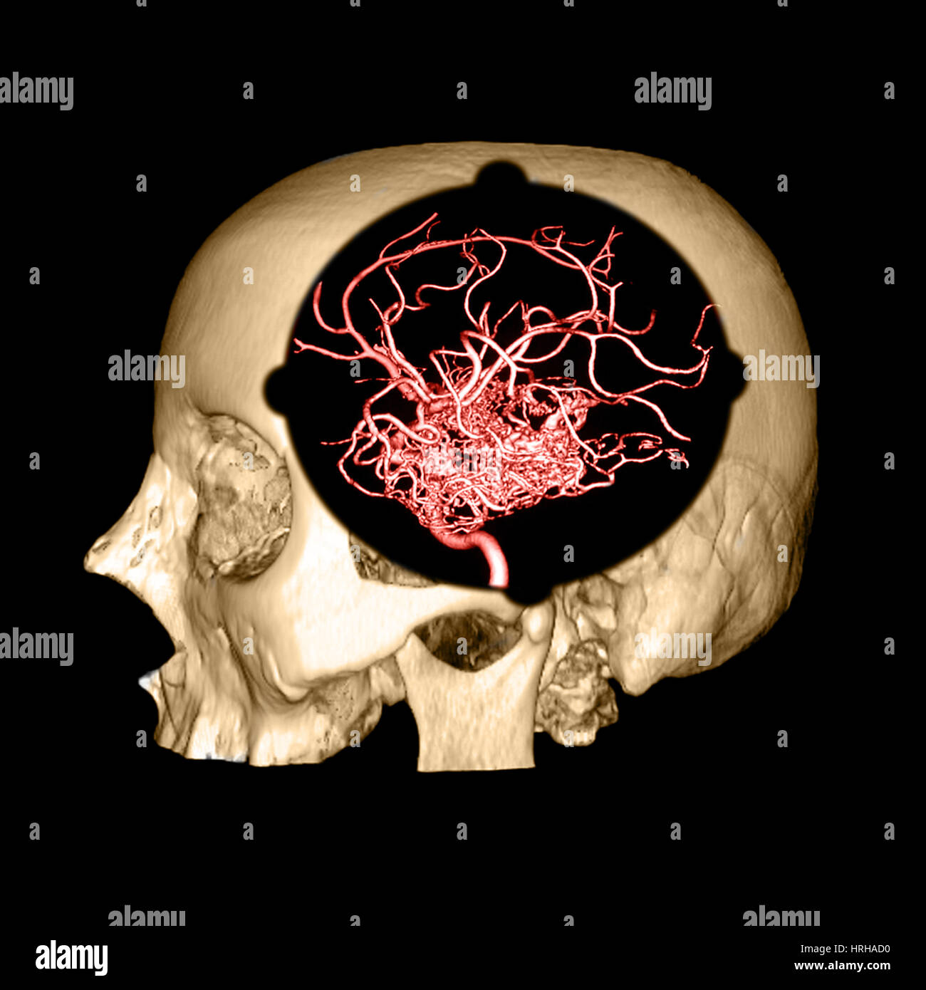 Brain arterial venous malformation hi-res stock photography and images ...