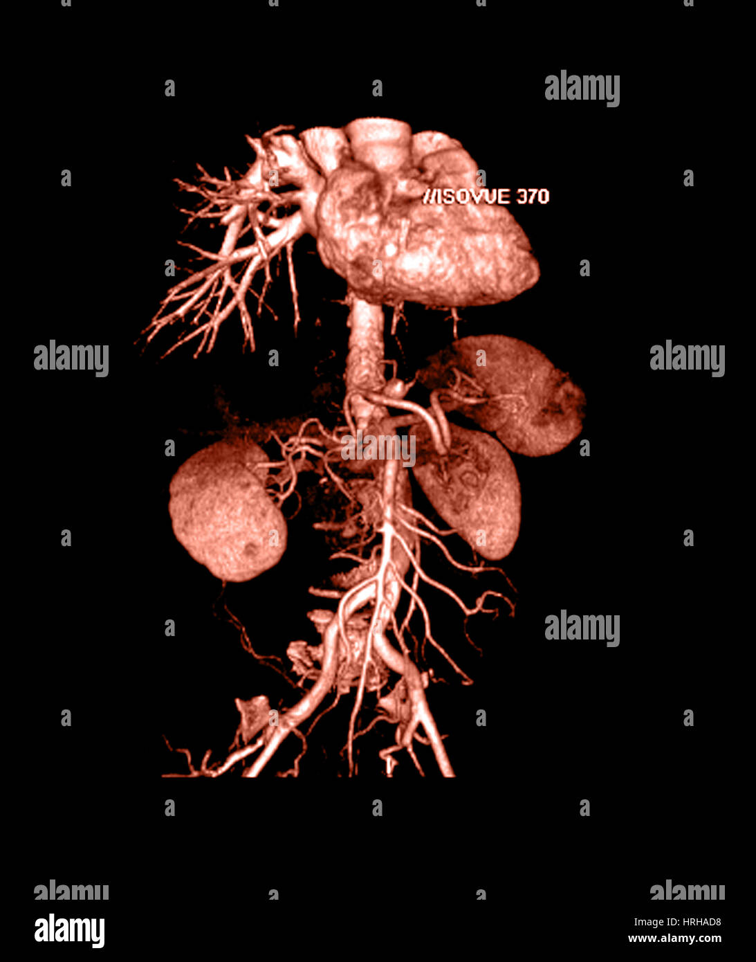 Angiogram of the abdominal aorta hi-res stock photography and images ...