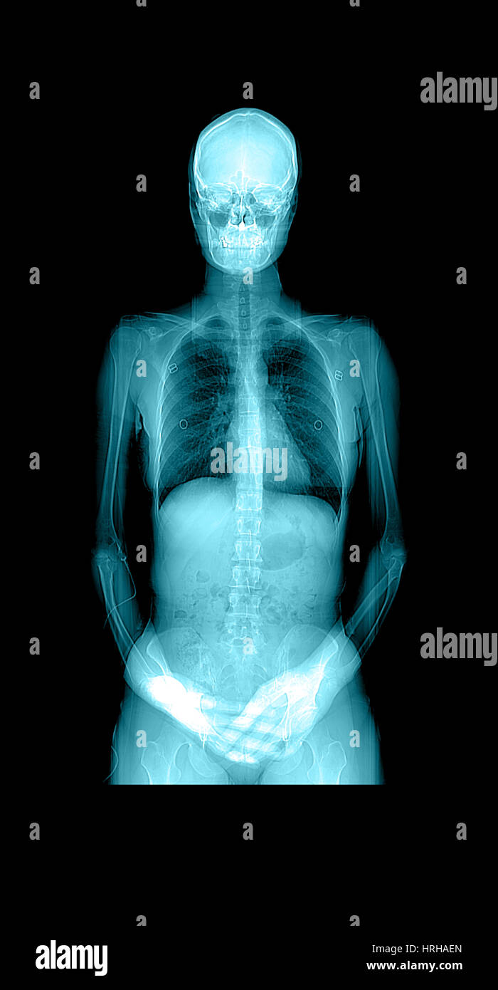 Human bodies x ray hi-res stock photography and images - Alamy