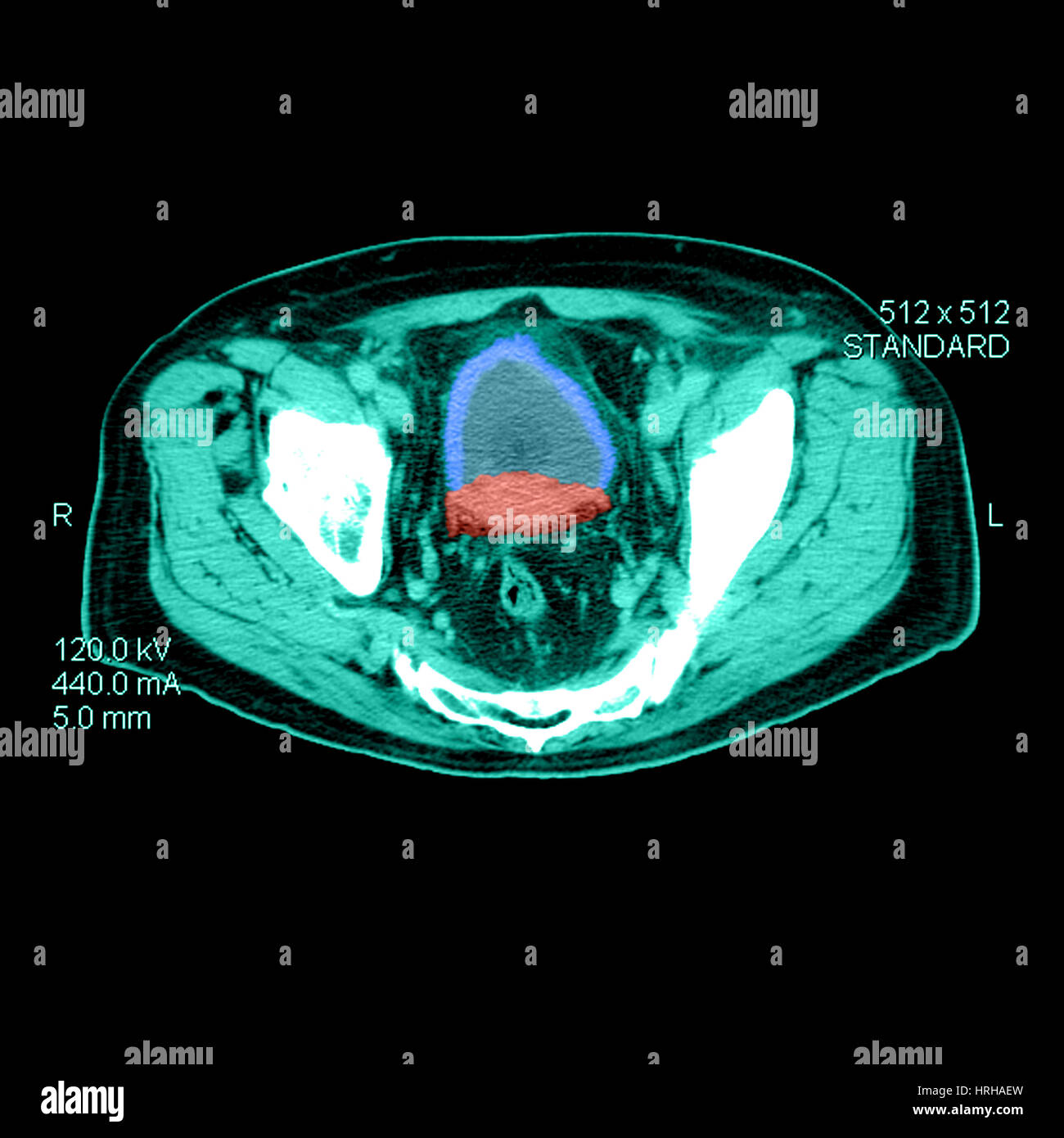 CT of Prostate Cancer Stock Photo - Alamy