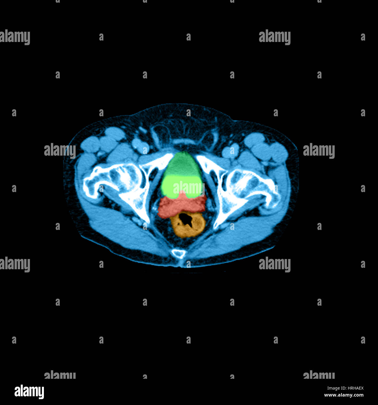 CT of Enlarged Prostate Stock Photo - Alamy