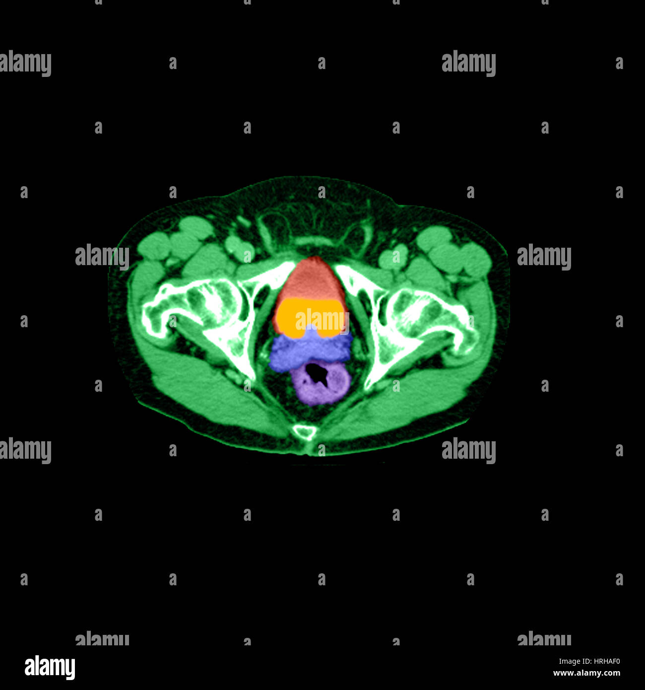 CT of Enlarged Prostate Stock Photo - Alamy