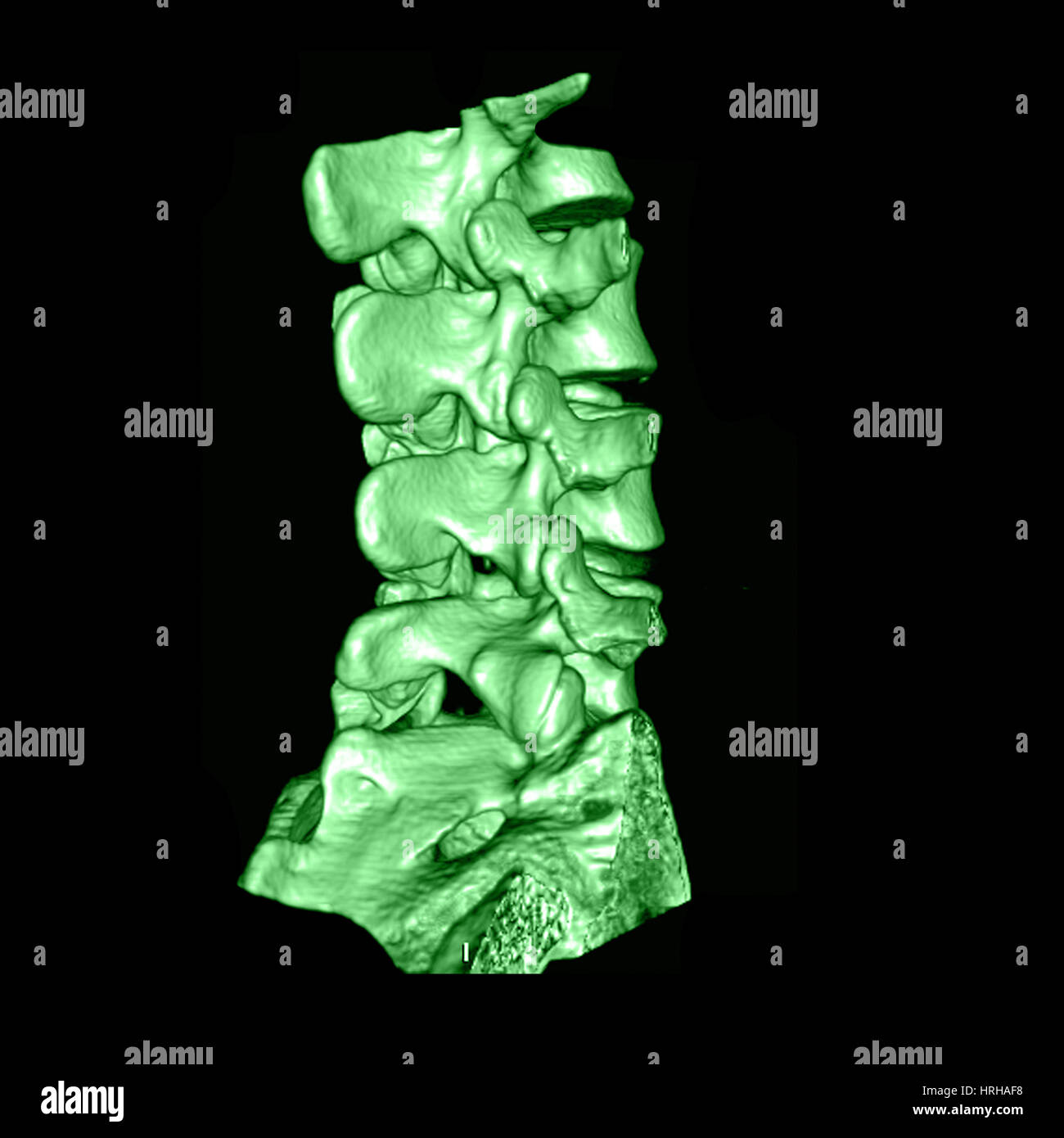 3d reconstruction of spine hi-res stock photography and images - Alamy