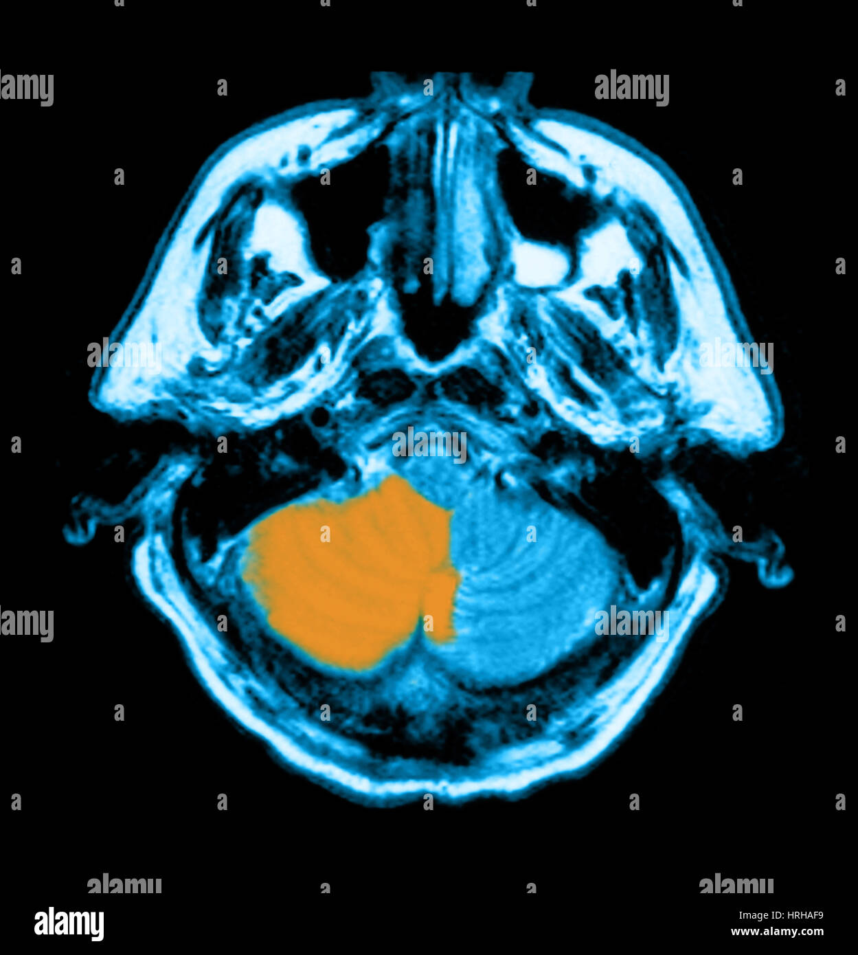 Mri of posterior fossa infarct hi-res stock photography and images - Alamy
