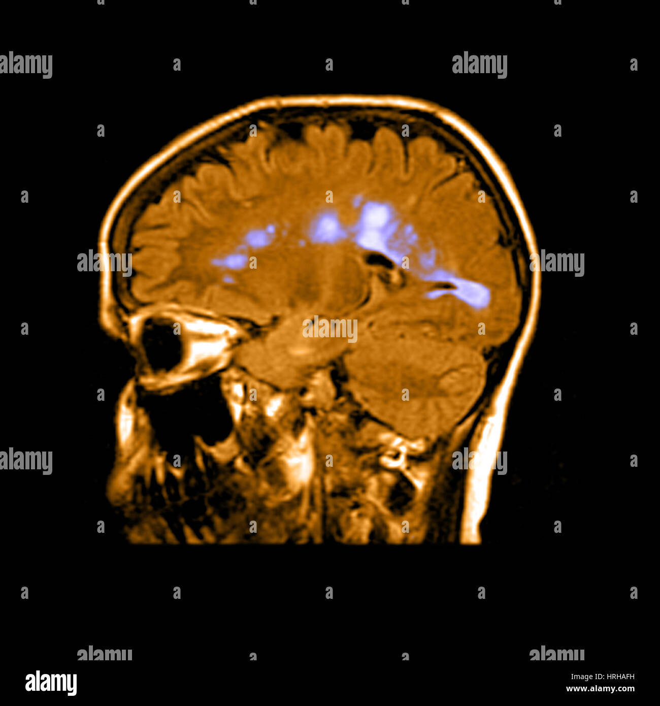 Multiple sclerosis mri hi-res stock photography and images - Alamy