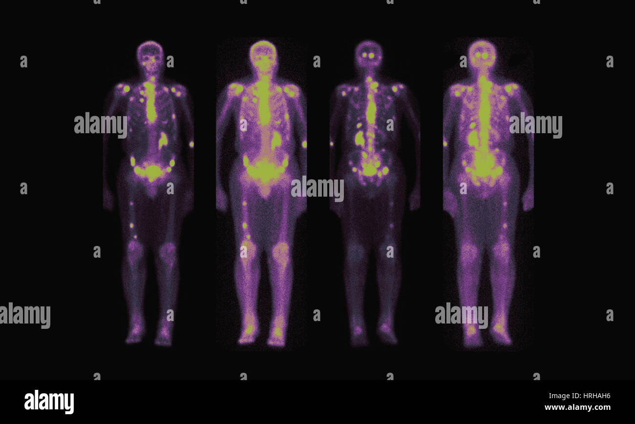 Abnormal bone scan hi-res stock photography and images - Alamy