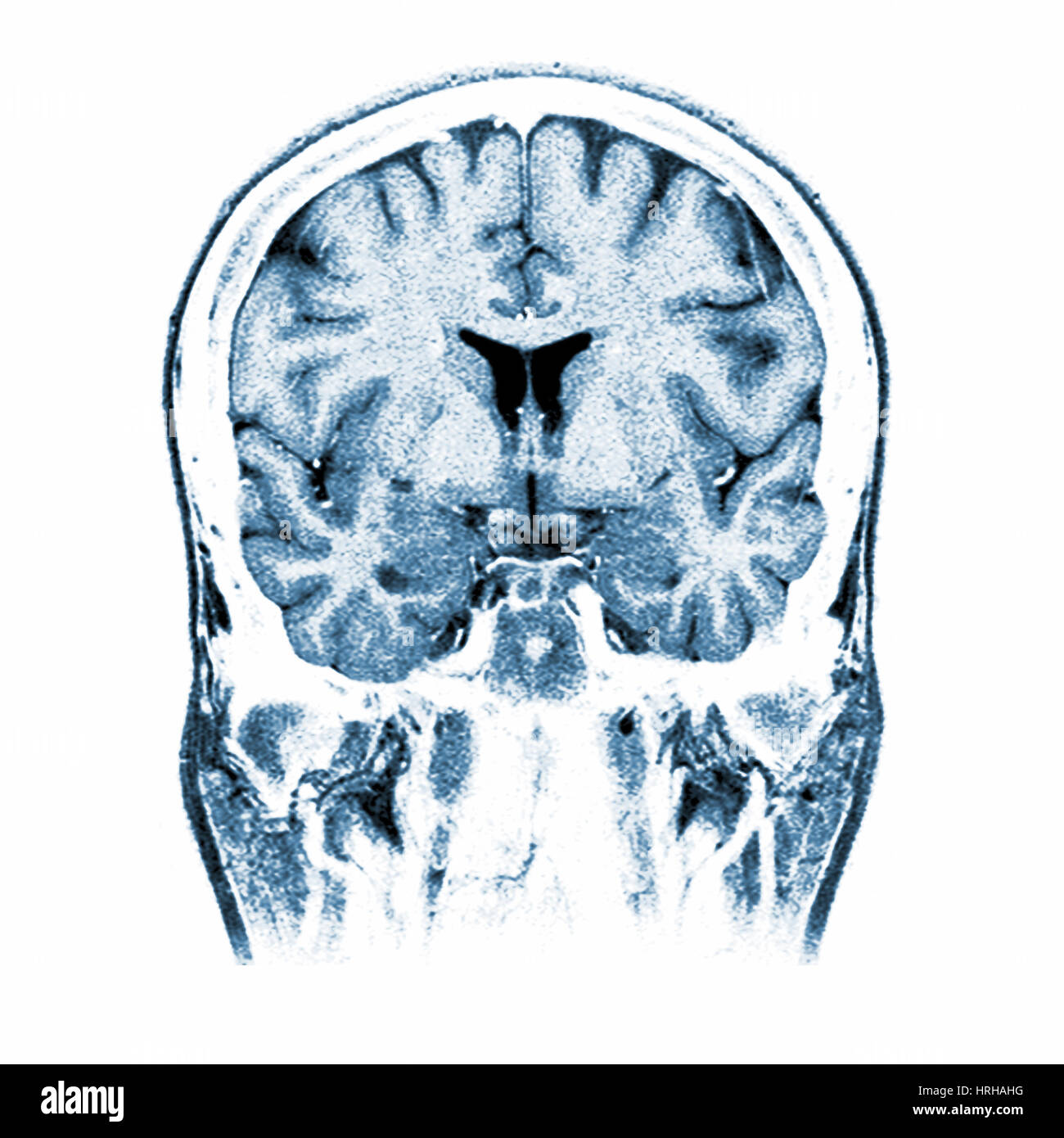 Mri brain scan normal Cut Out Stock Images & Pictures - Alamy