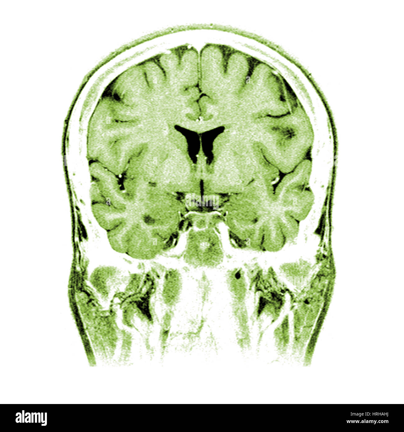 Ressonancia Magnetica Cerebral Normal Coronal