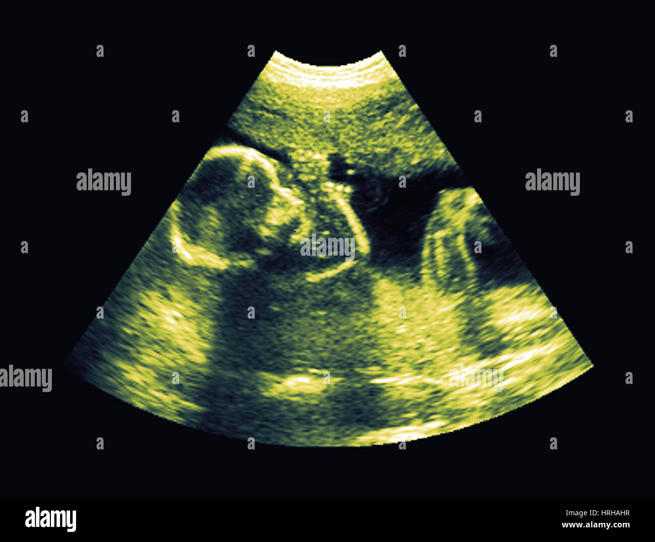 Ultrasound of Fetus Stock Photo - Alamy