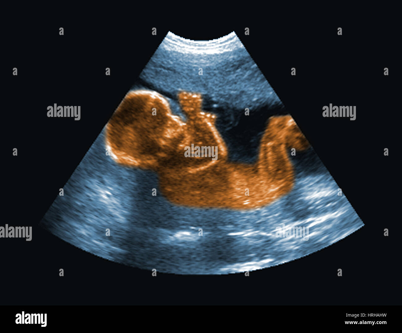 Ultrasound of Fetus Stock Photo - Alamy