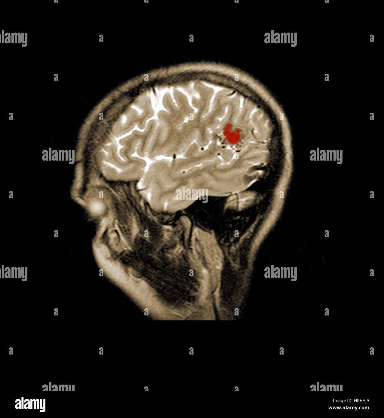 Abnormal mri of brain hi-res stock photography and images - Alamy