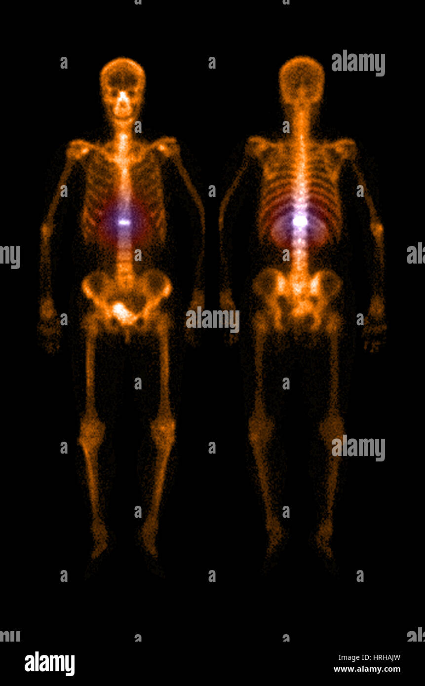 T12 compression fracture hi-res stock photography and images - Alamy