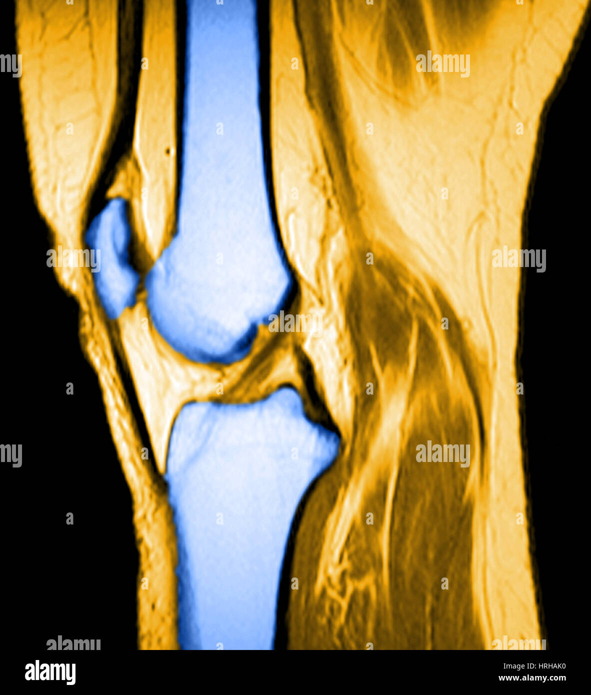 Knee Ligament Mri High Resolution Stock Photography and Images - Alamy