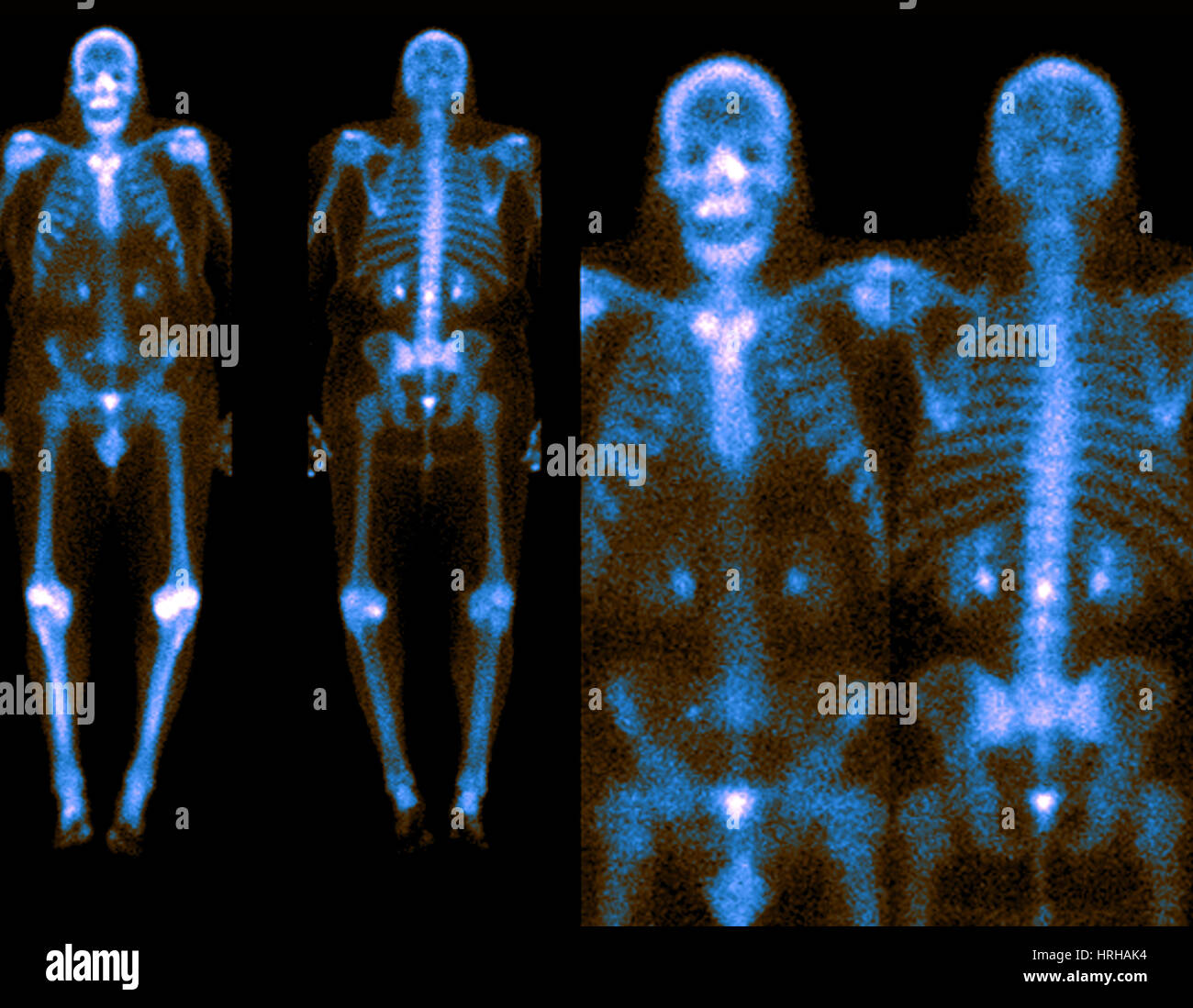 Nuclear bone scan hi-res stock photography and images - Alamy