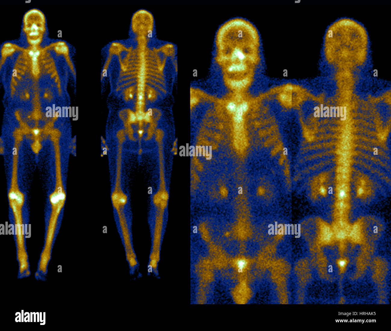 Nuclear bone scan hi-res stock photography and images - Alamy