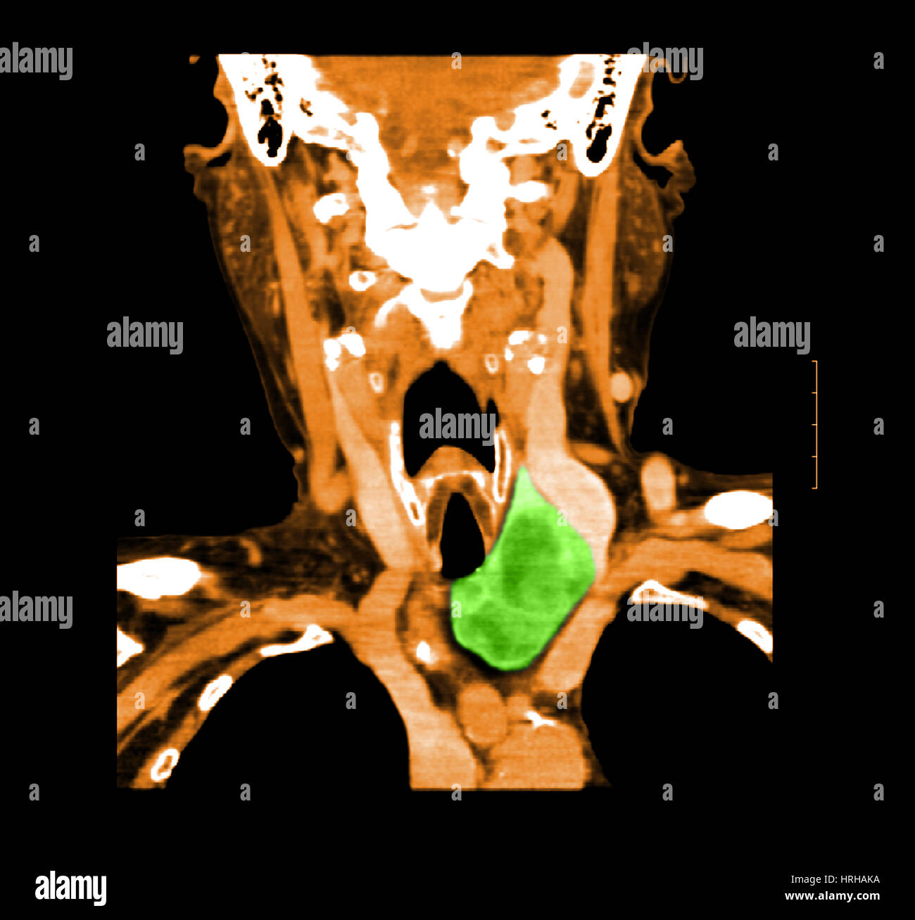 Goiter, neck hi-res stock photography and images - Alamy