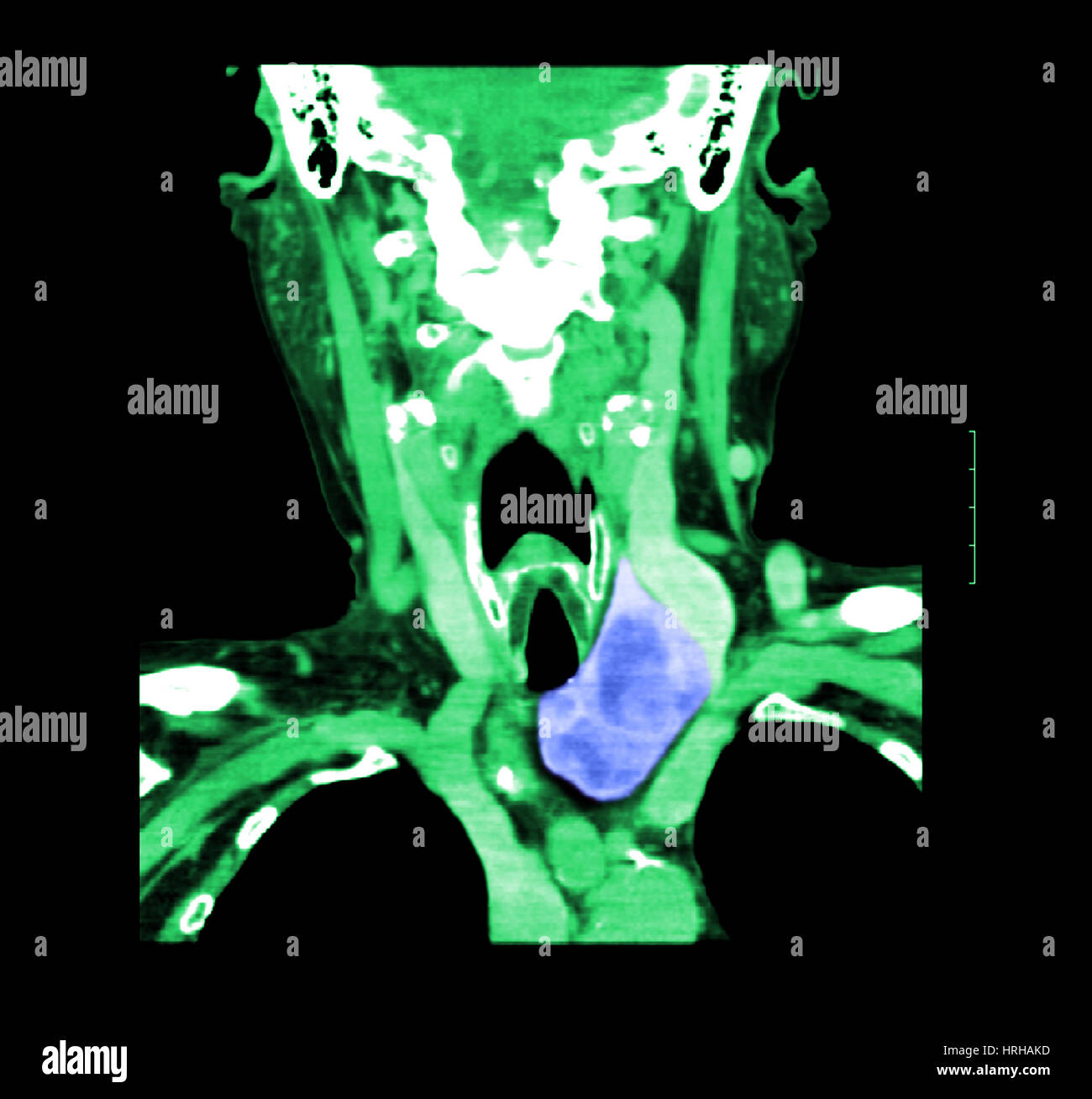 CT of neck showing thyroid goiter Stock Photo - Alamy