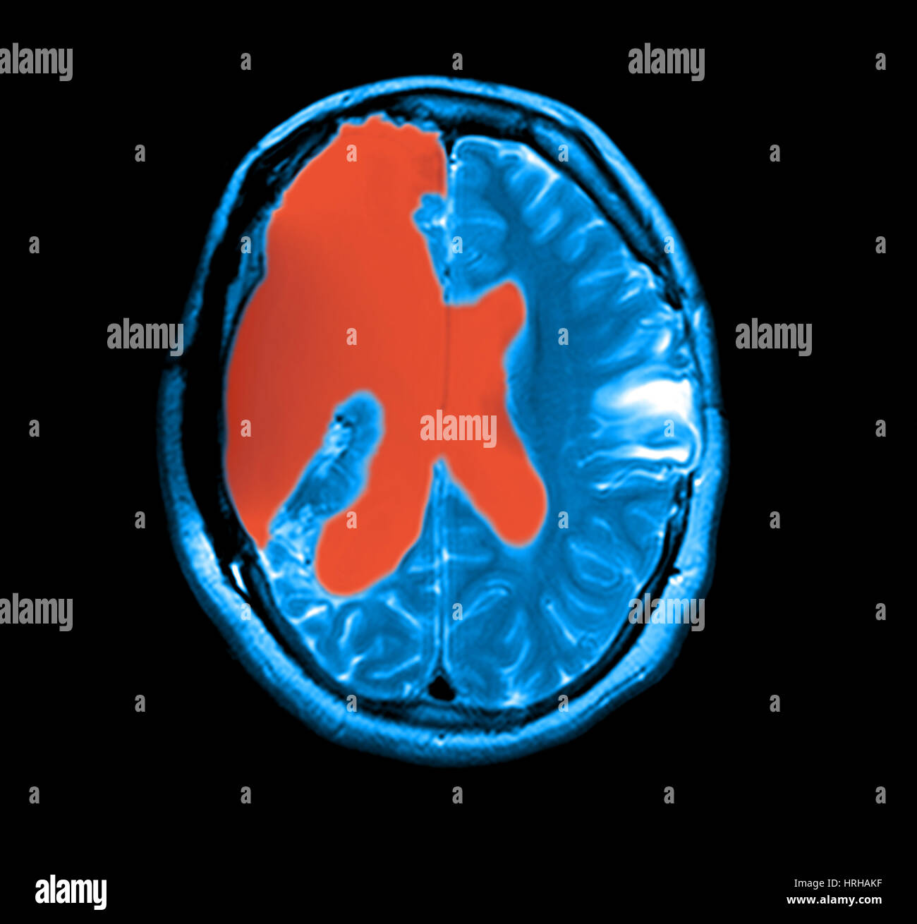 MRI shows near total hemispherectomy Stock Photo - Alamy