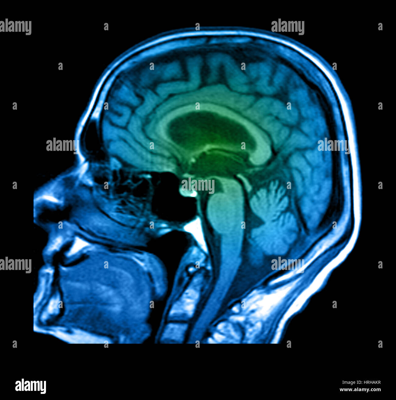 Hydrocephalus hi-res stock photography and images - Alamy