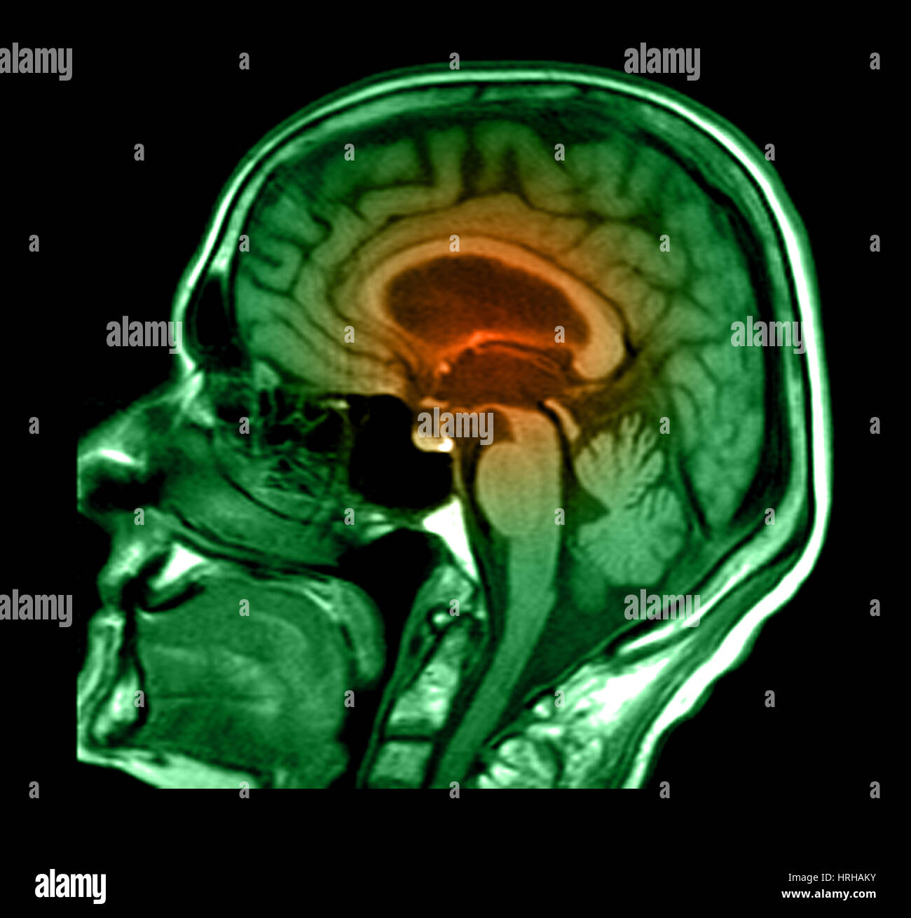 Normal Pressure Hydrocephalus Stock Photo - Alamy