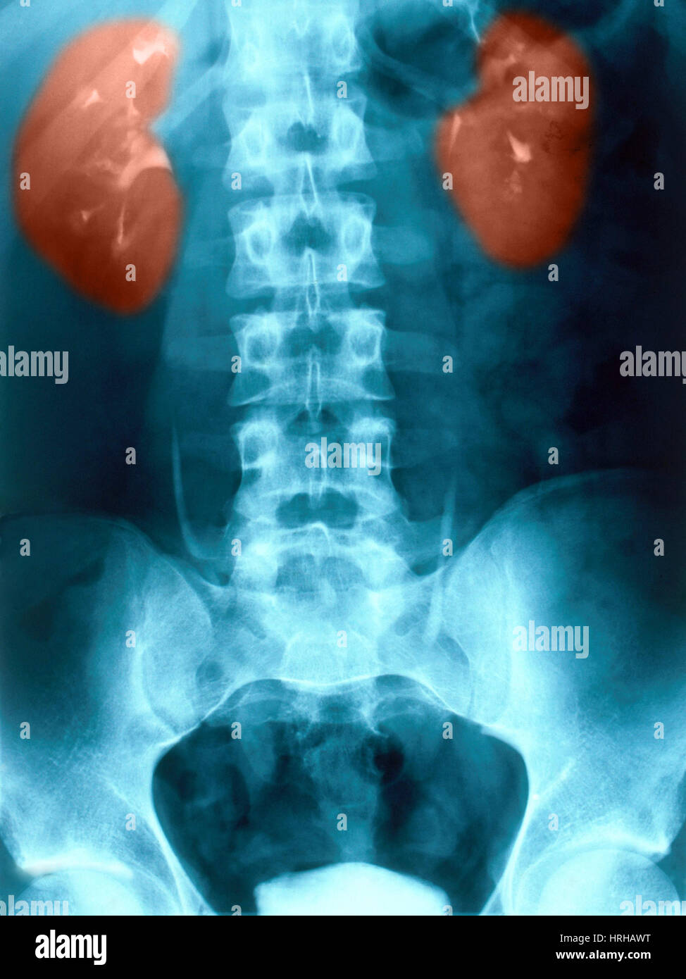 X-ray of Normal Kidneys Stock Photo - Alamy