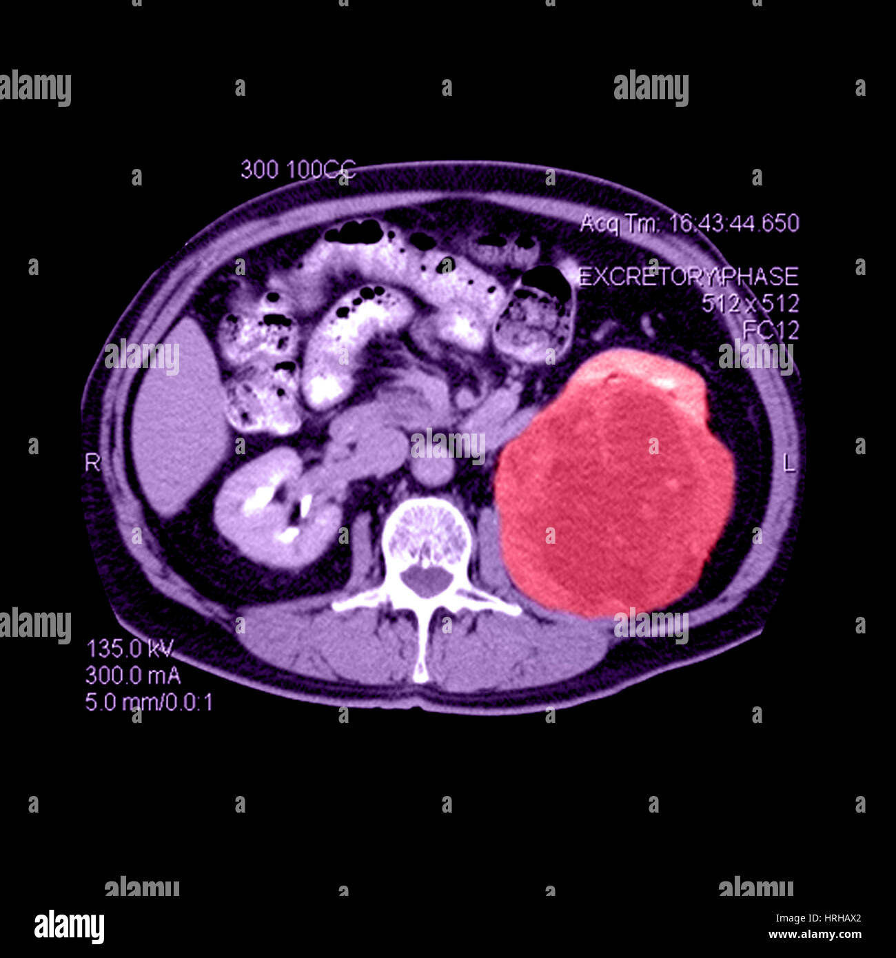 Abnormal ct of abdomen hi-res stock photography and images - Alamy