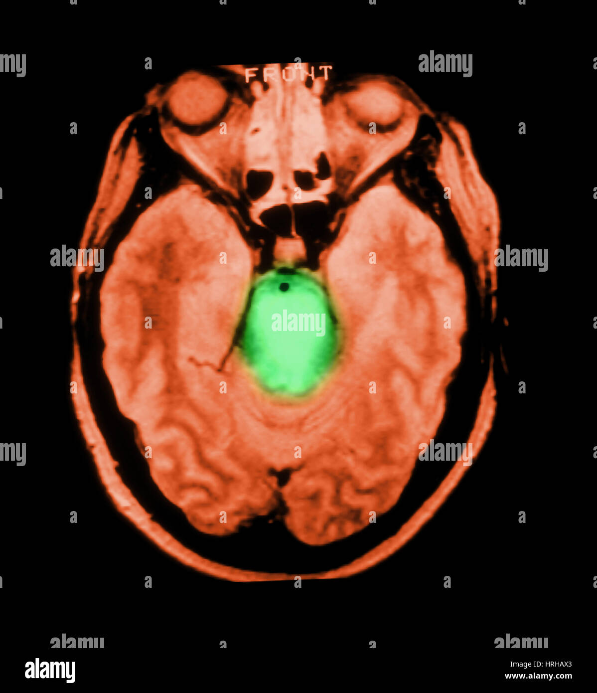 Mri of brainstem tumor hi-res stock photography and images - Alamy